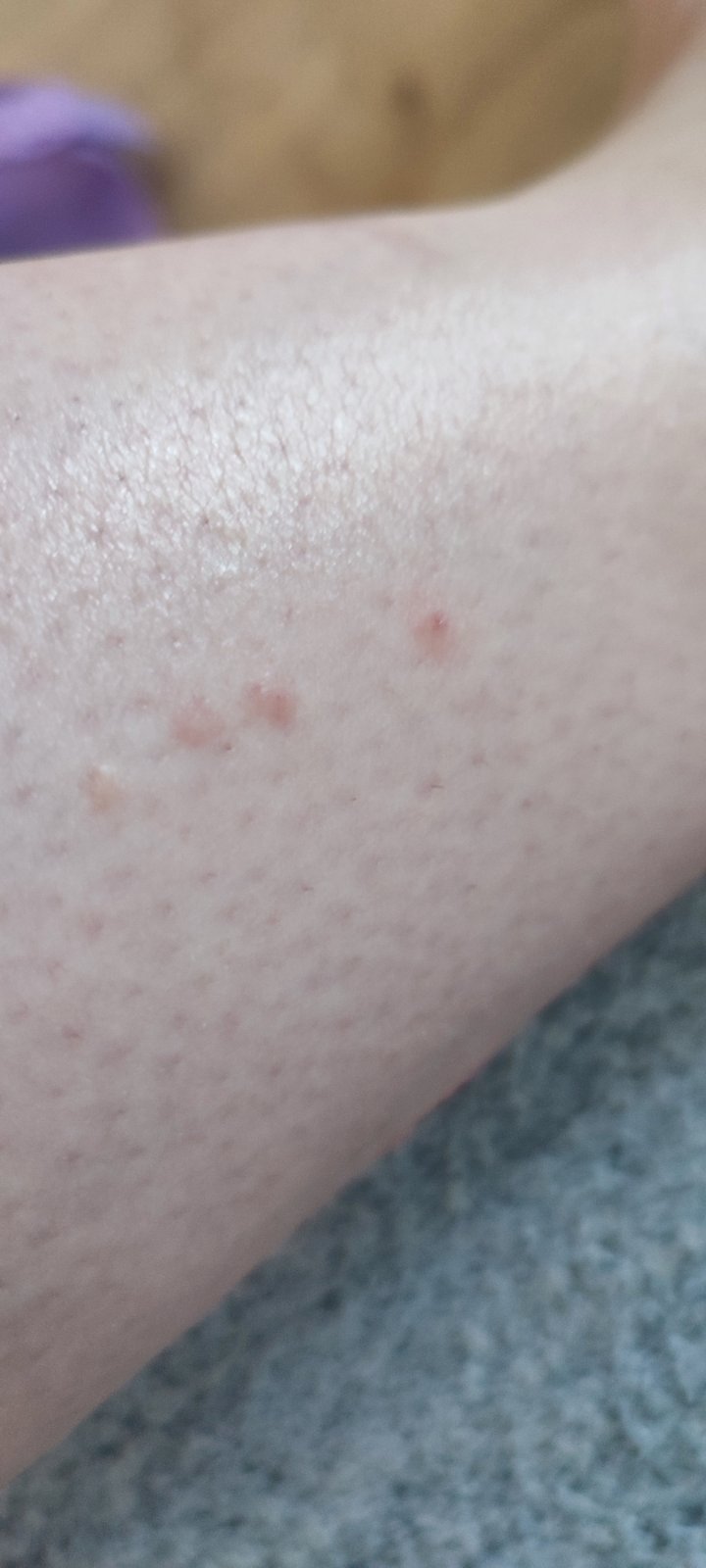 Sú toto štípance od ploštice? - Modrý koník