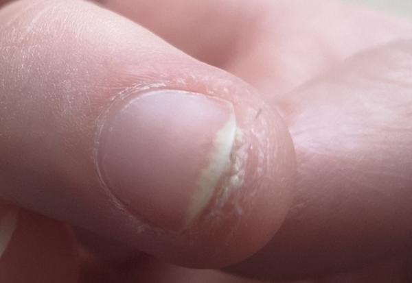 Čo sa mi to stalo s prstom? - Modrý koník