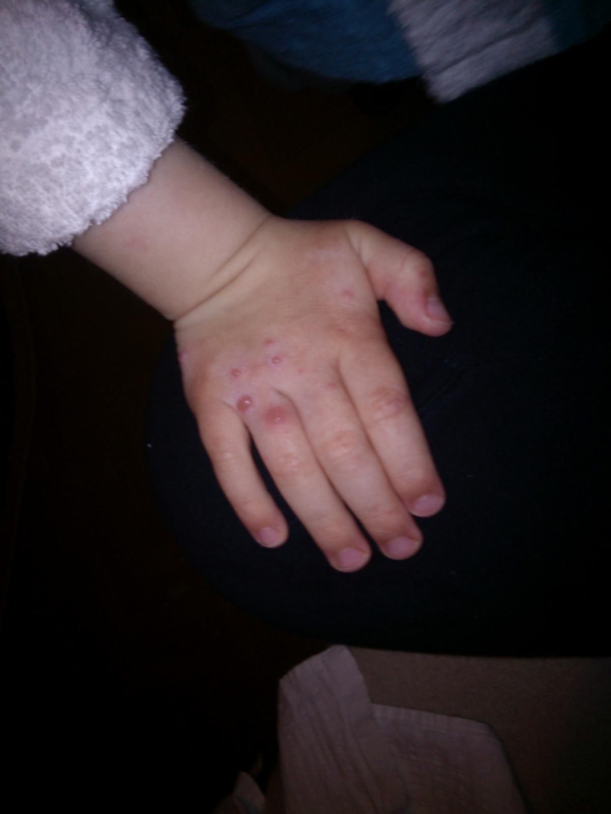 Vodnaté pľuzgiere na rukách 3,5 ročného syna. Poradíte? - Modrý koník