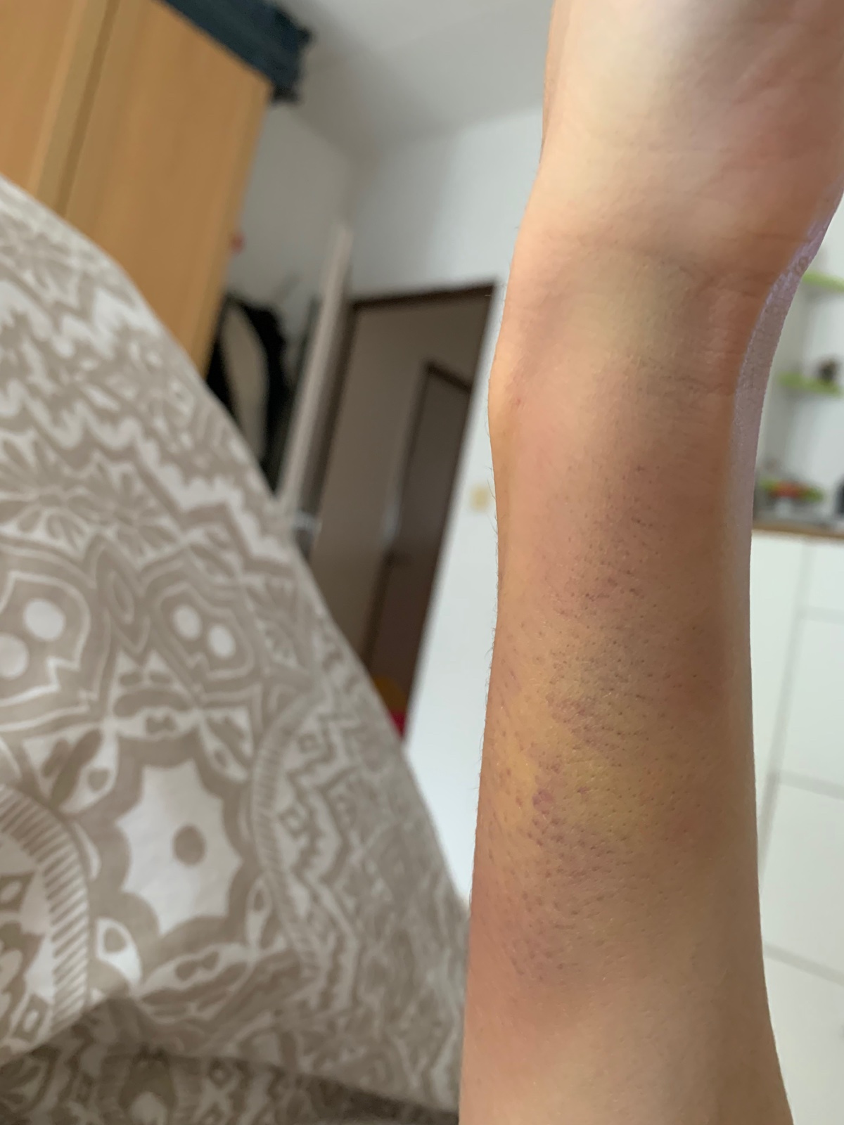 Modrina na zápästí - Modrý koník