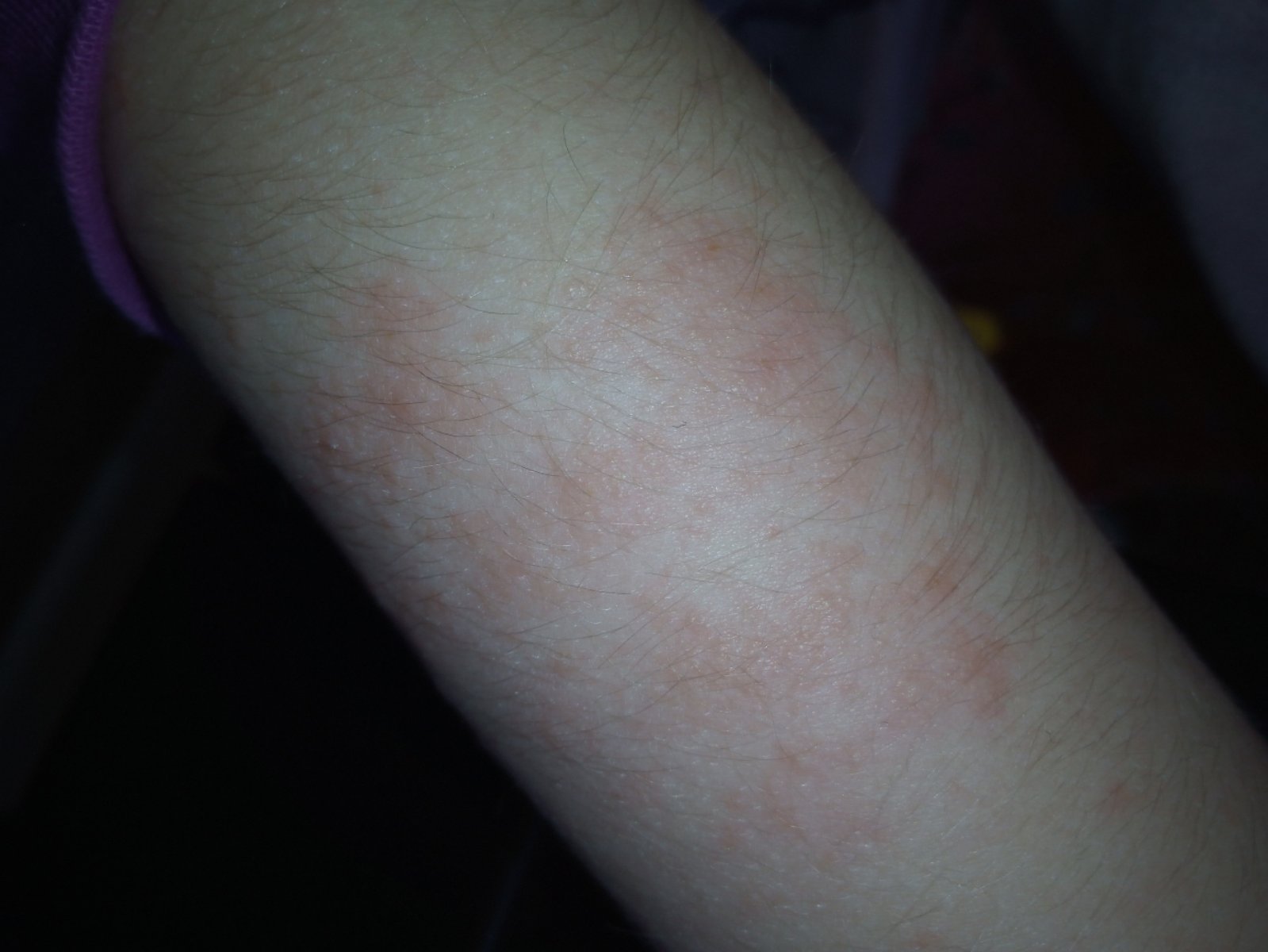 Vyrážky na rukách 3,5-ročnej dcérky - Modrý koník