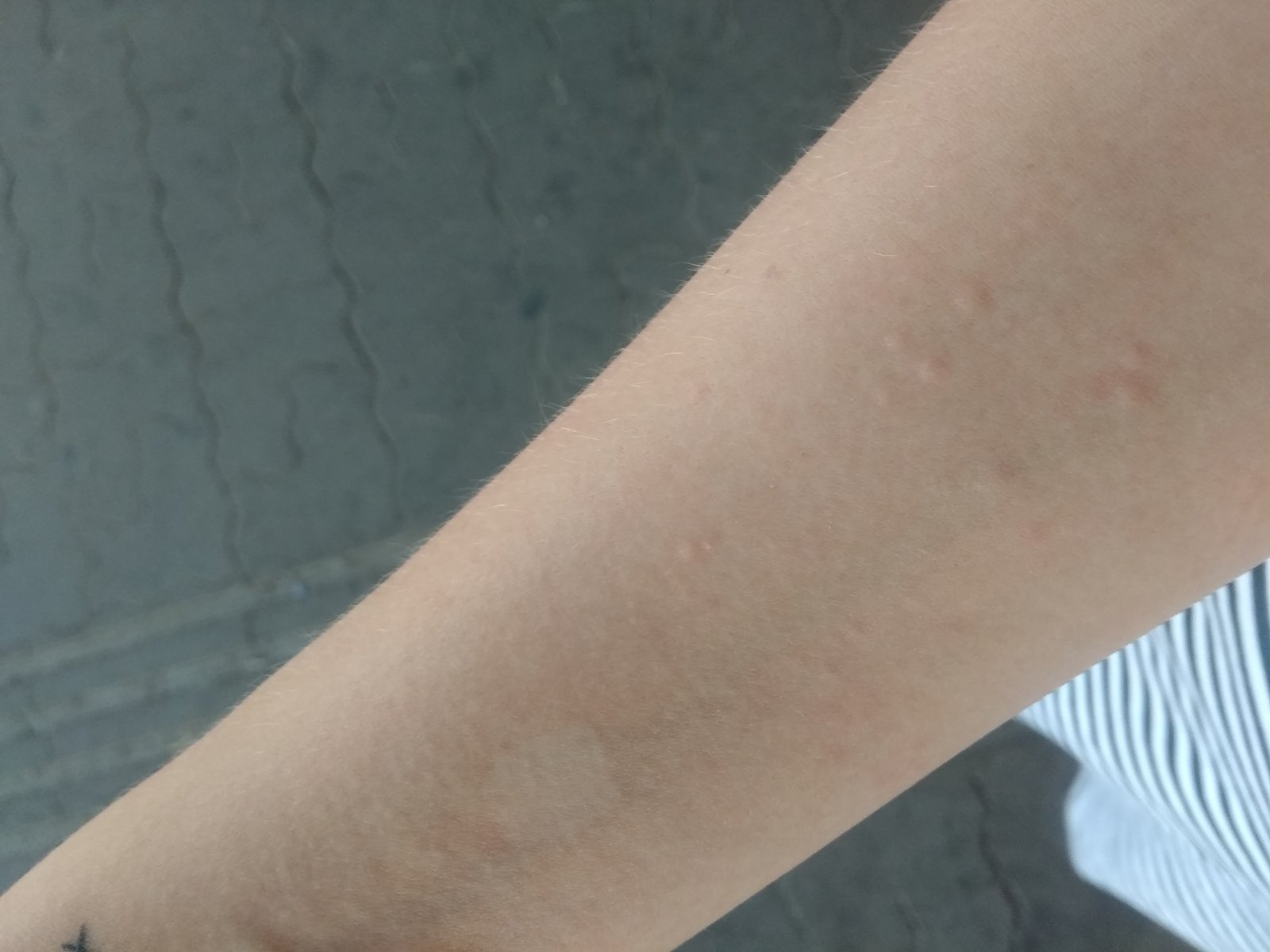 Malé svrbivé vyrážky na rukách a nohách. - Modrý koník