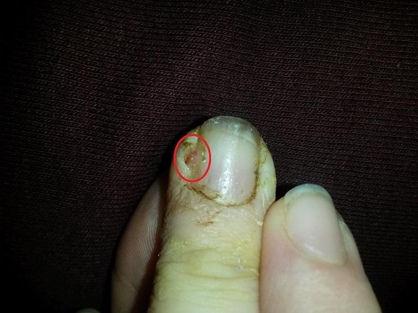 Výrastok pri nechte na ruke - Modrý koník