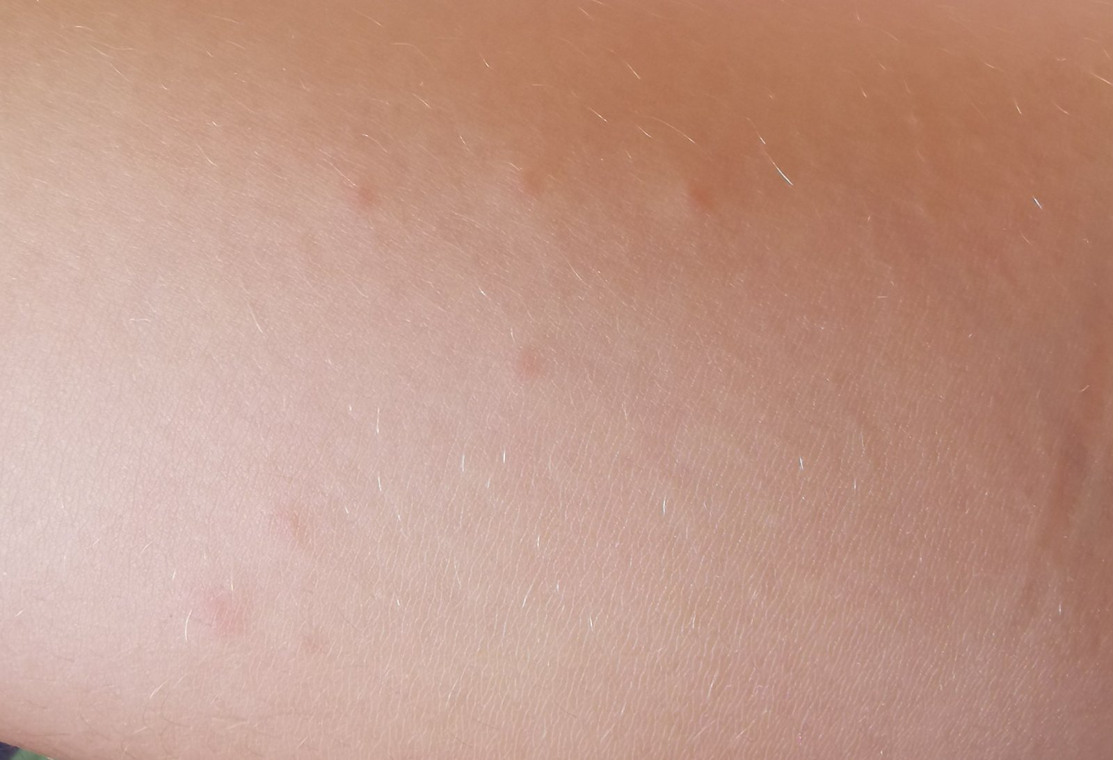 Čo sú to za štípance na dcérinom lýtku? - Modrý koník