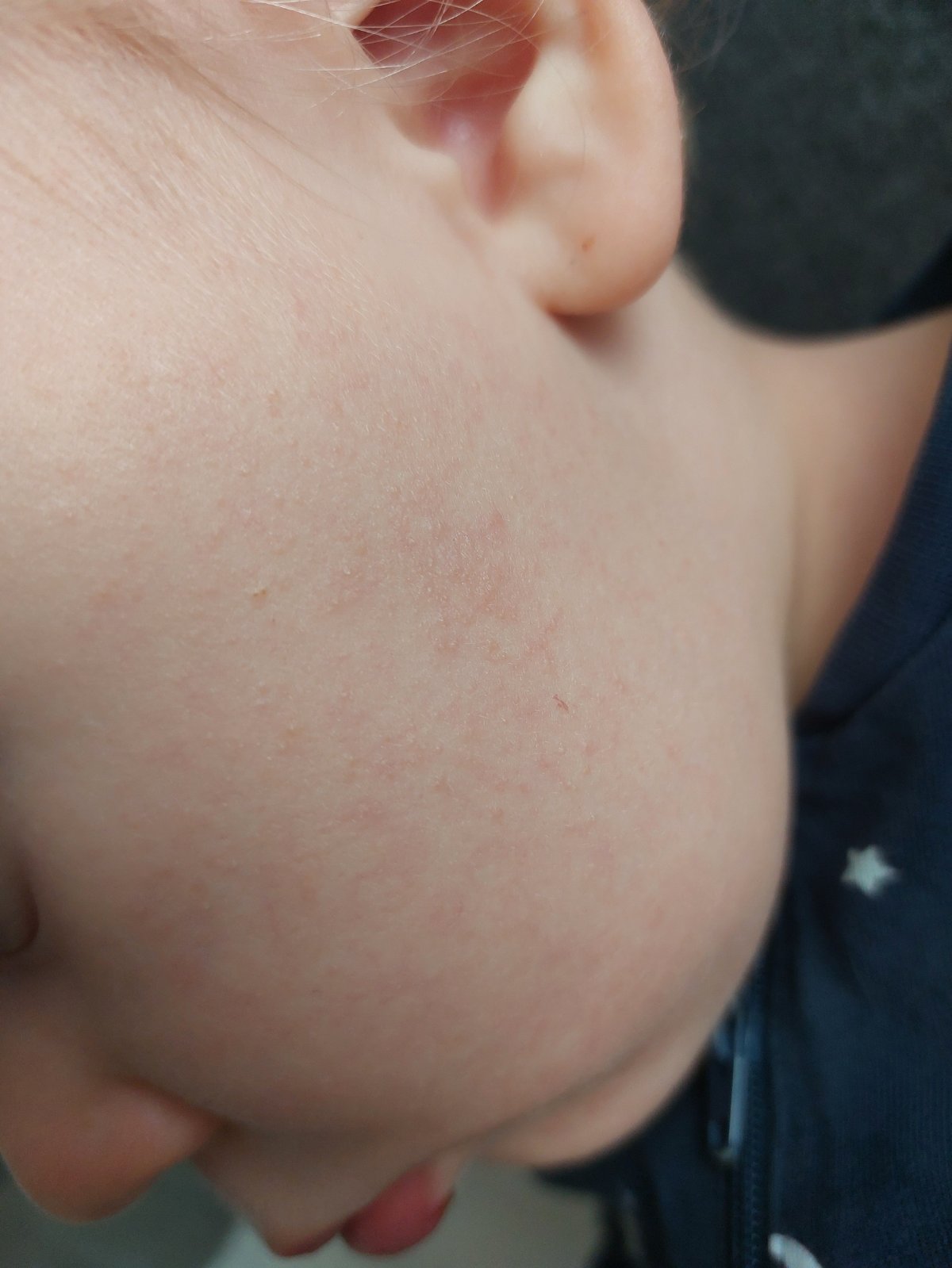 Vyrážky na lícach 21-mesačného syna - Modrý koník