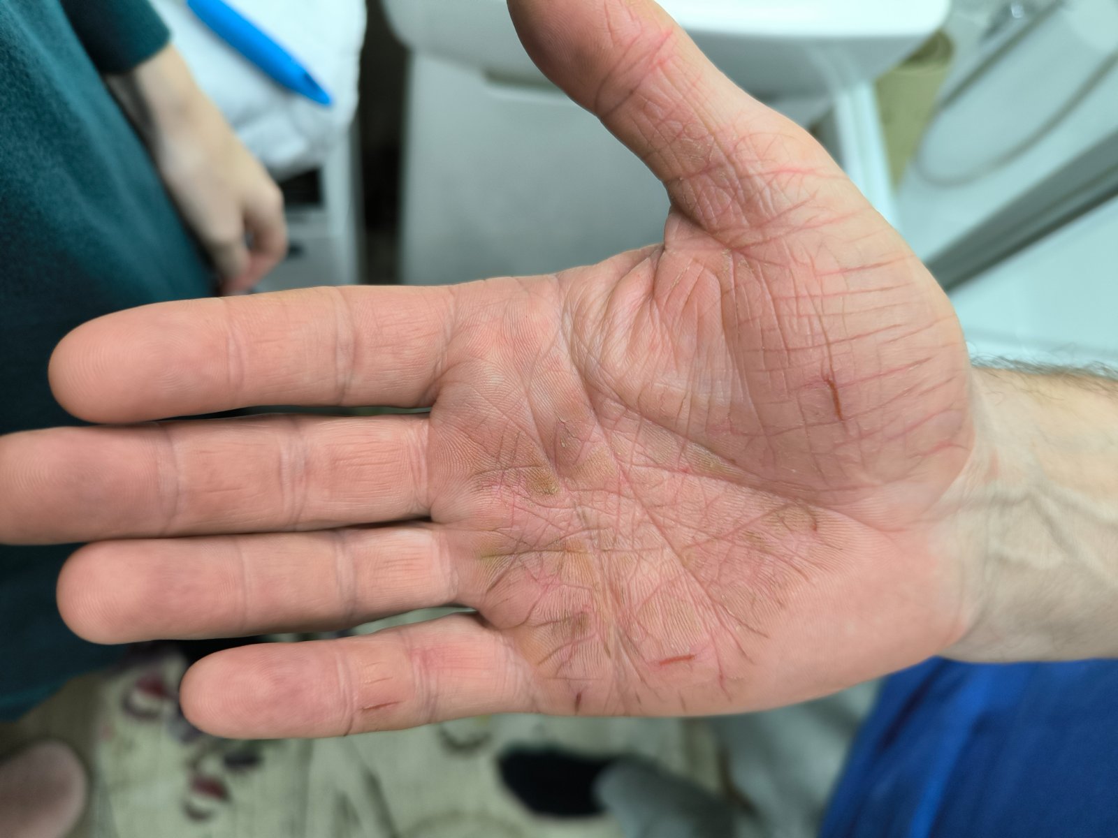 Zhrubnutá suchá koža na rukách - Modrý koník