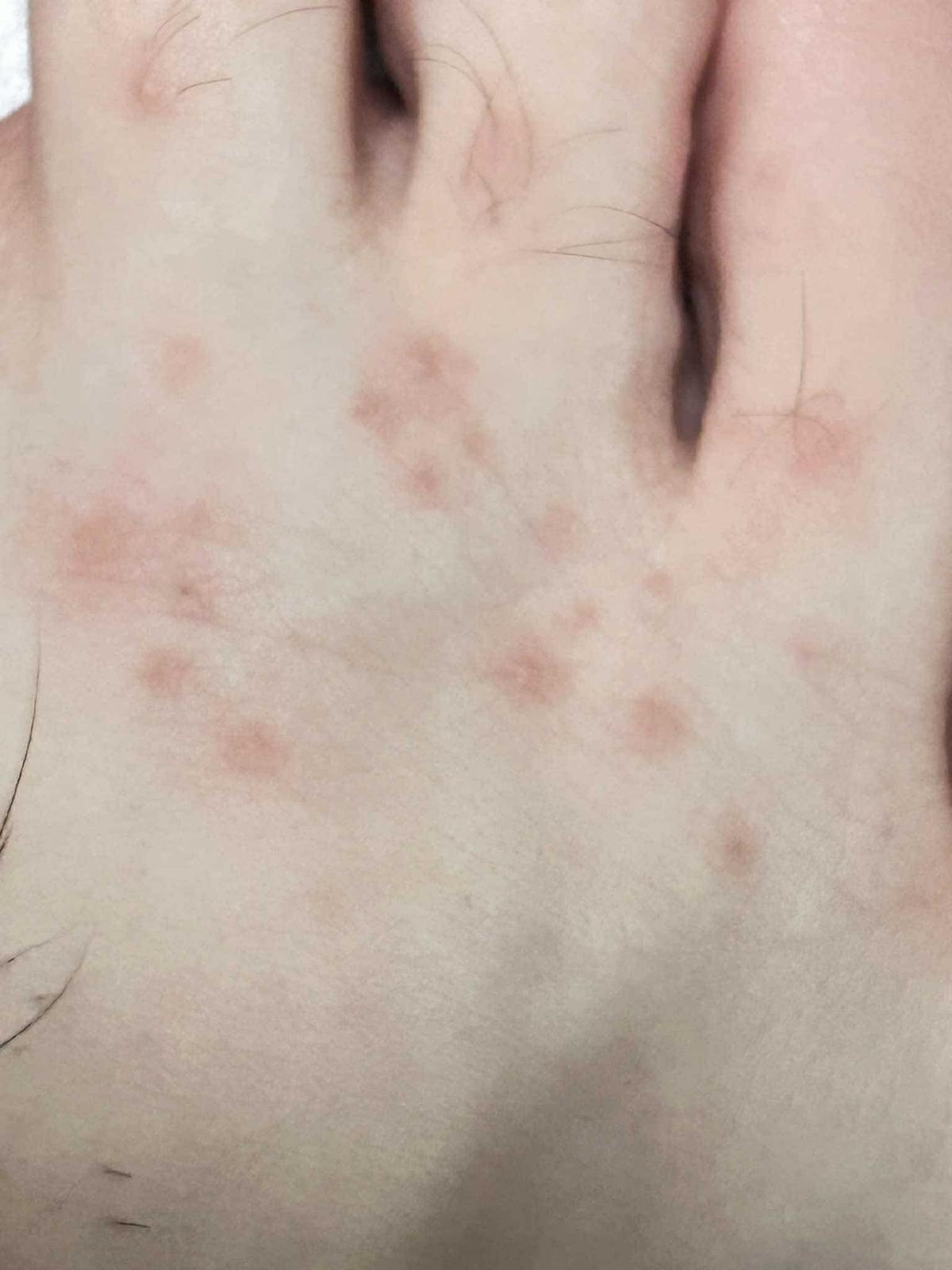 Svrbiace vyrážky po tele - Modrý koník