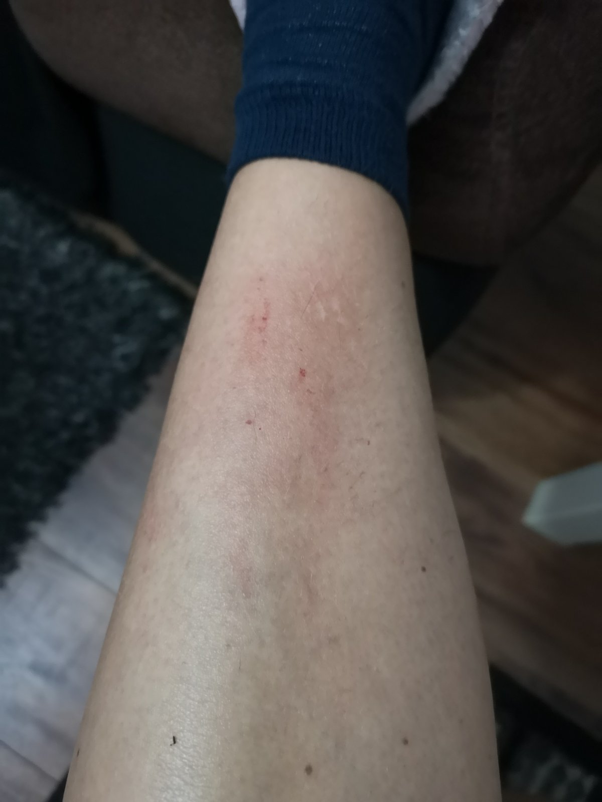 Ekzém na nohe - Modrý koník