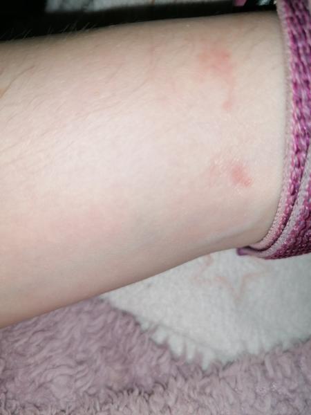 Je to podráždenie na ruke? - Modrý koník