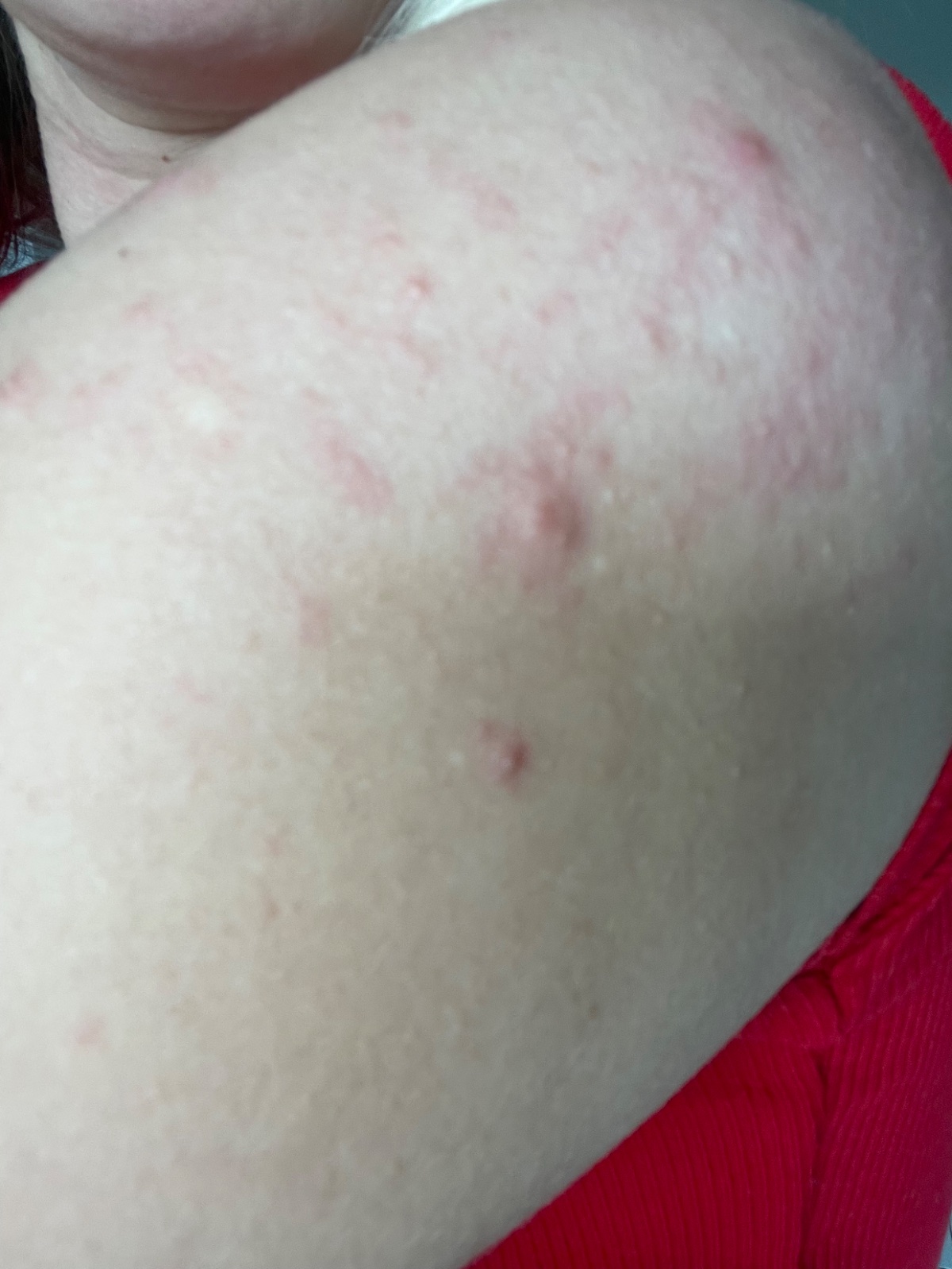 Vyrážky na ramenách - Modrý koník