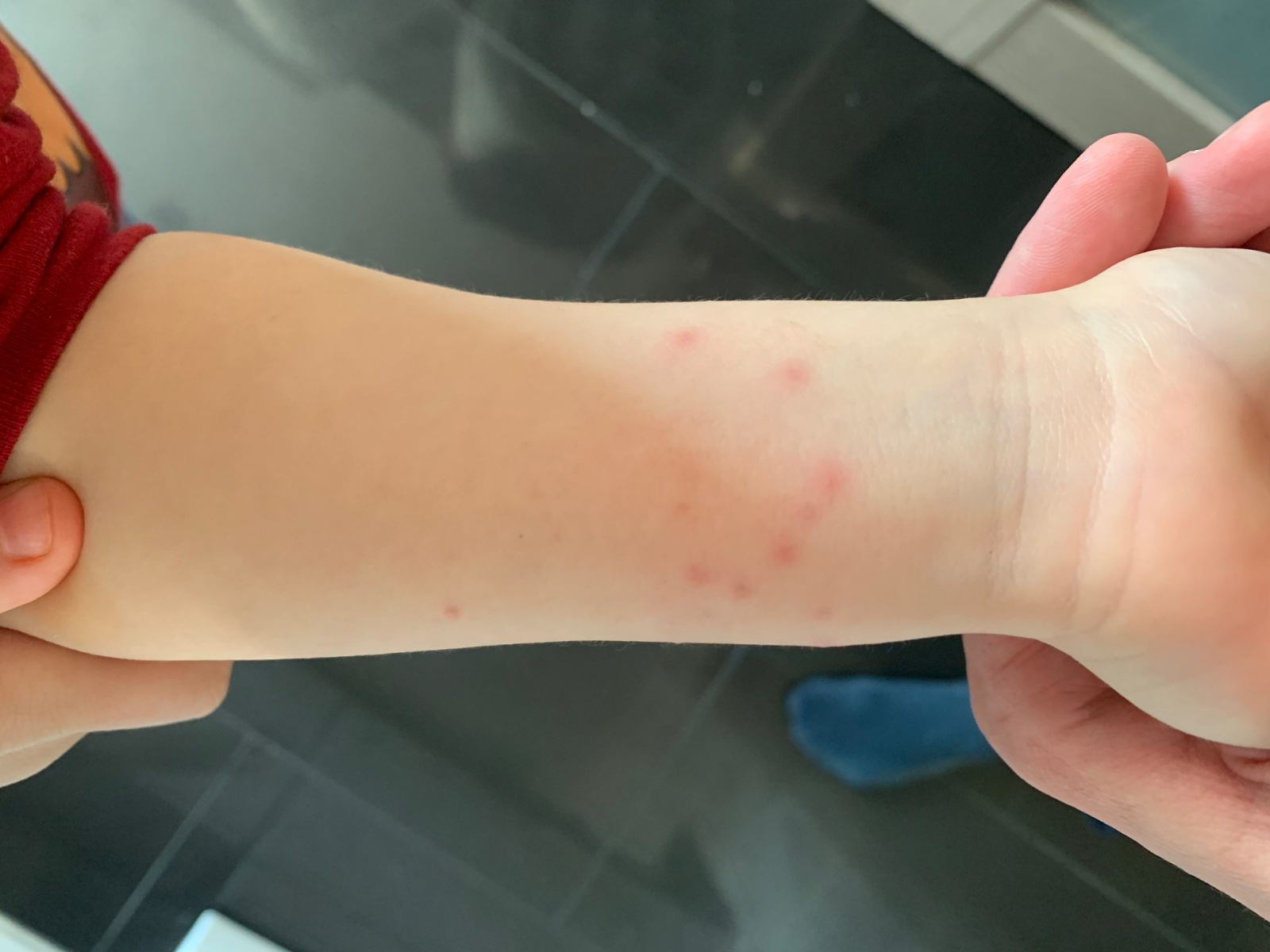 Vyrážky na predlaktiach dieťaťa: Ako ich liečiť? - Modrý koník