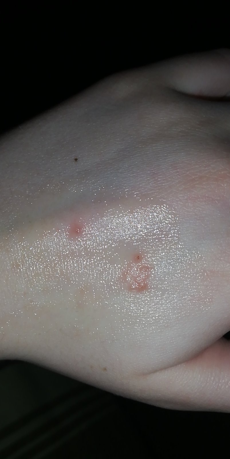 Kožné vyrážky na ruke - Modrý koník