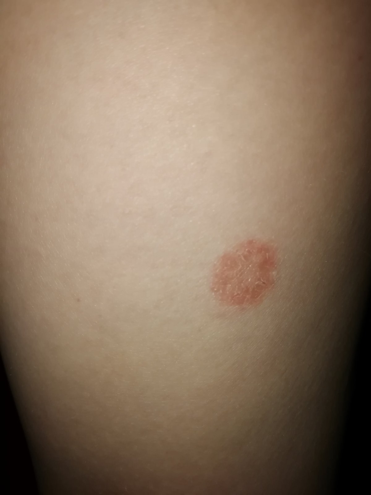 Vyrážky u syna - Modrý koník