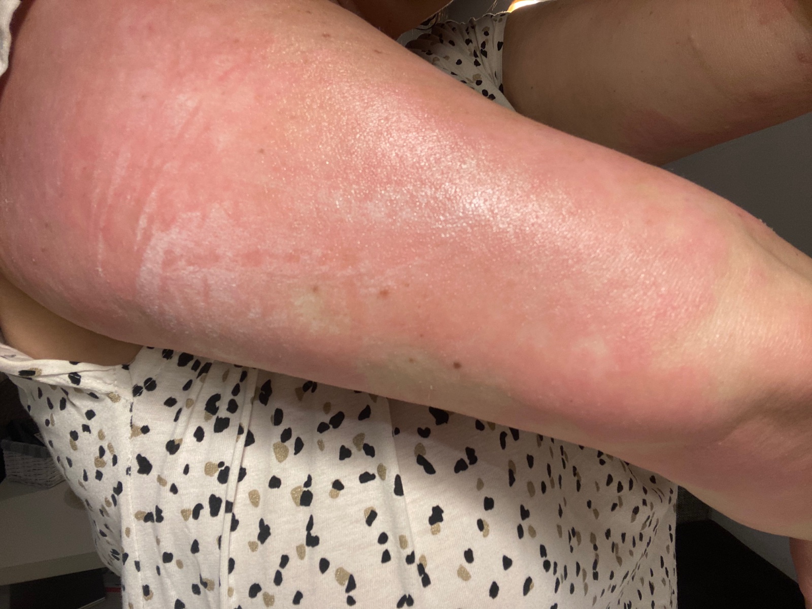 Zhoršený atopický ekzém po tehotenstve - Modrý koník