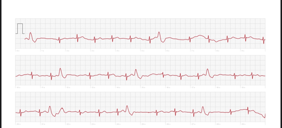 Ako sa prejavujú extrasystoly? - Modrý koník