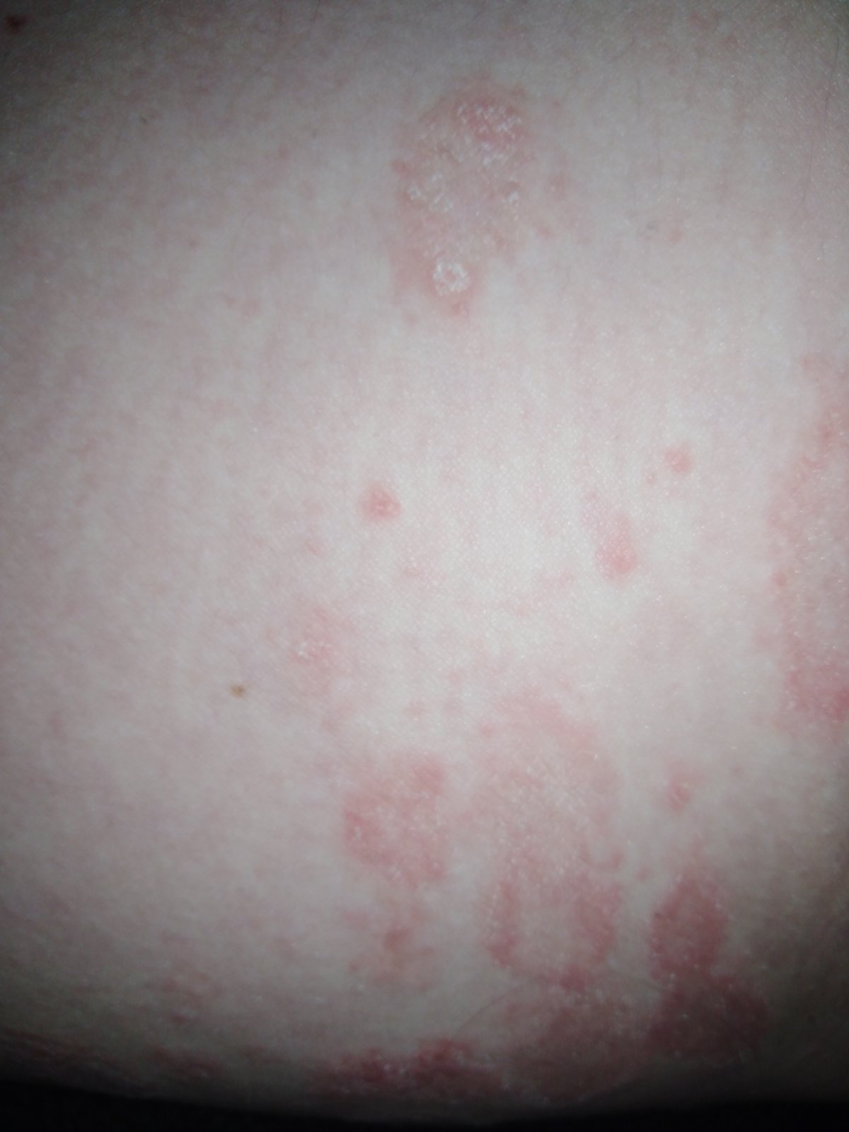 Vyrážky na tele už 2-3 týždne, čo to môže byť ? - Modrý koník