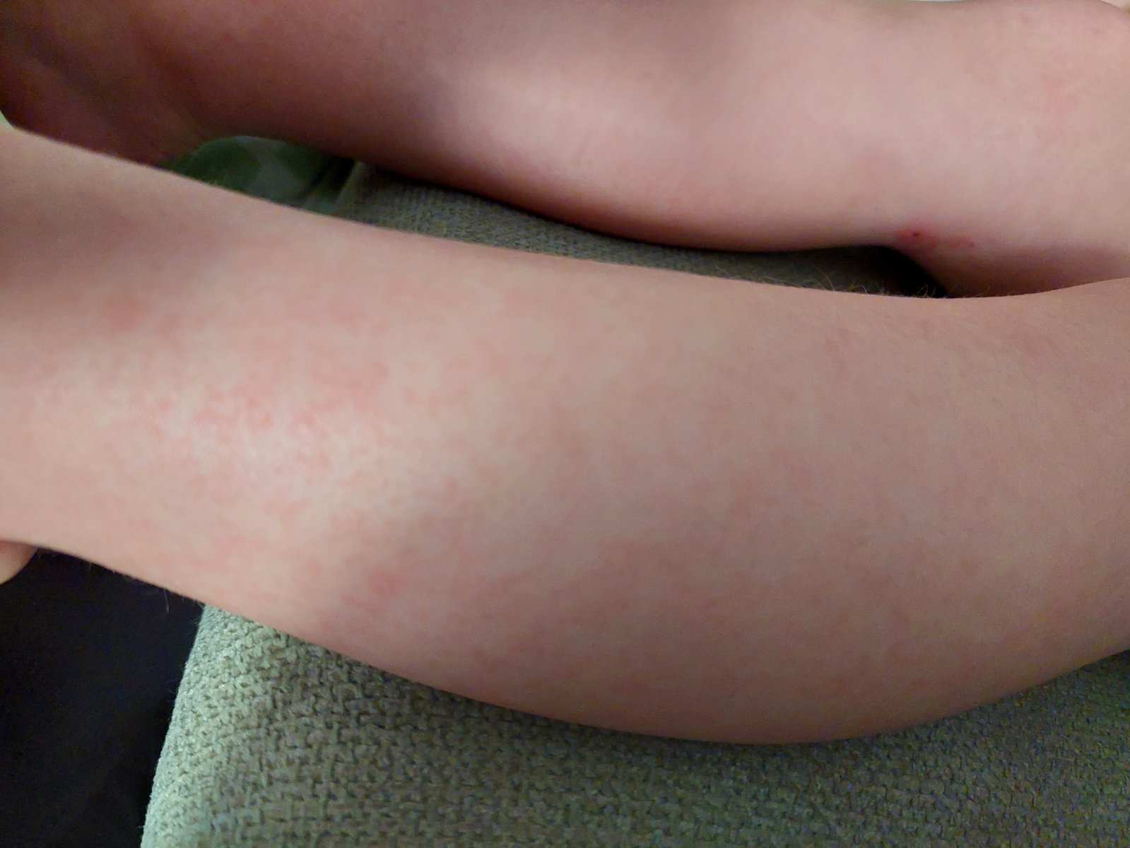 Ruky-nohy-ústa - Modrý koník