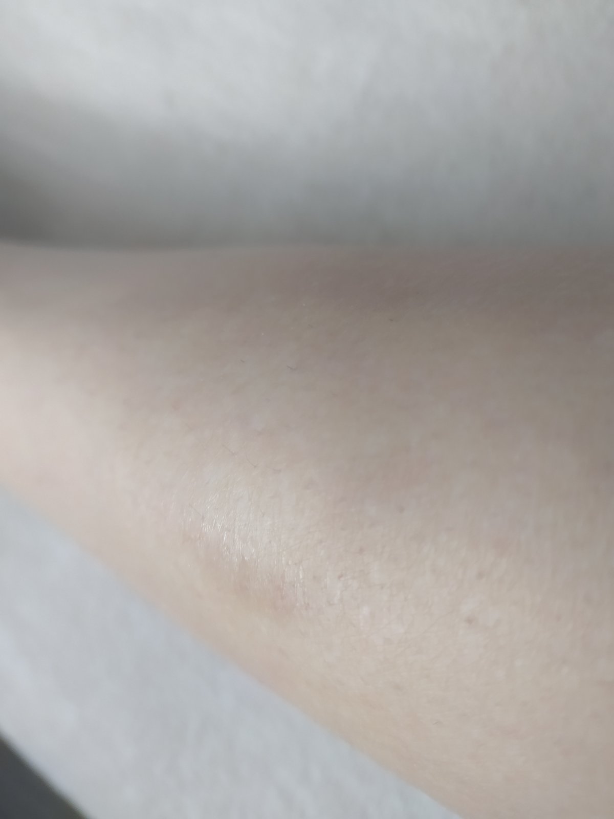 Opuch na nohe - Modrý koník