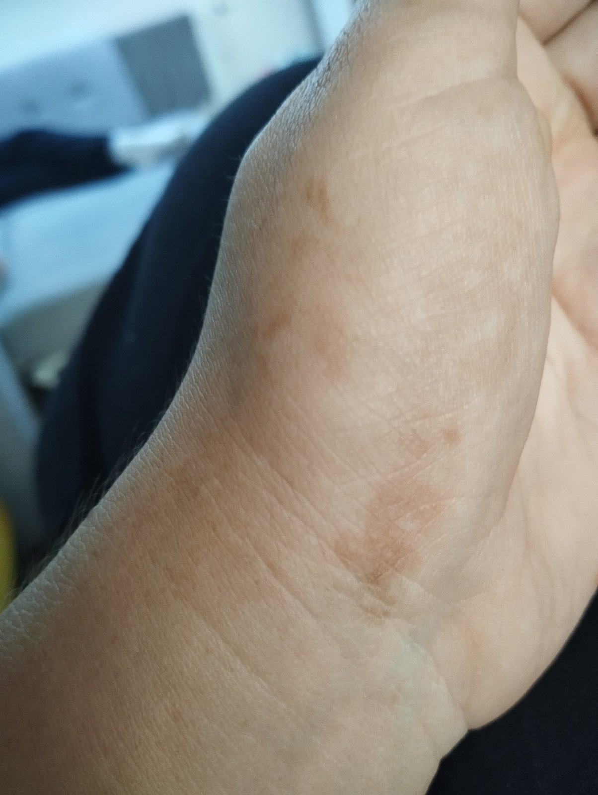 Hnedé fľaky na ruke - Modrý koník