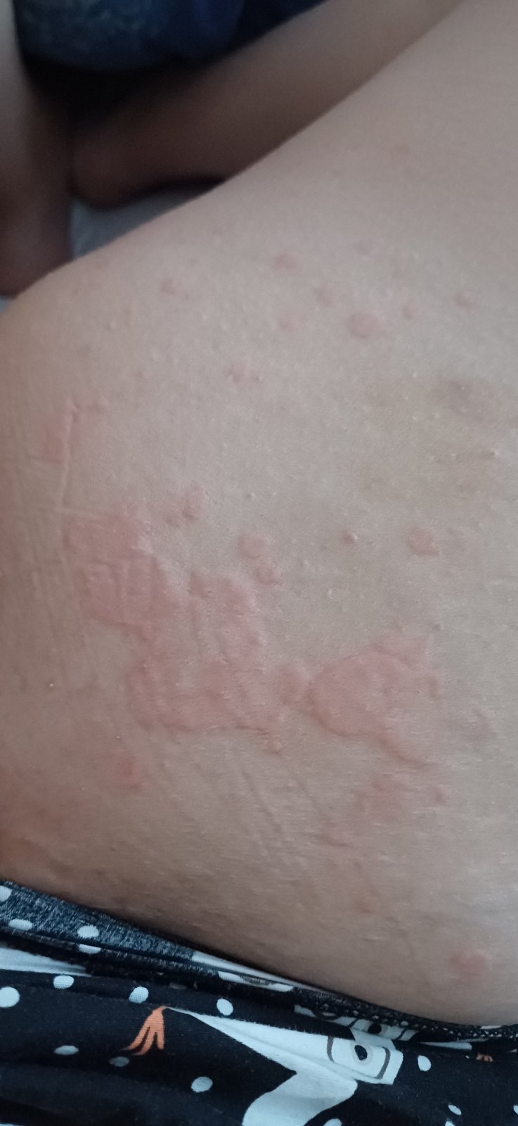 Čo sa mi objavilo na stehnách? - Modrý koník