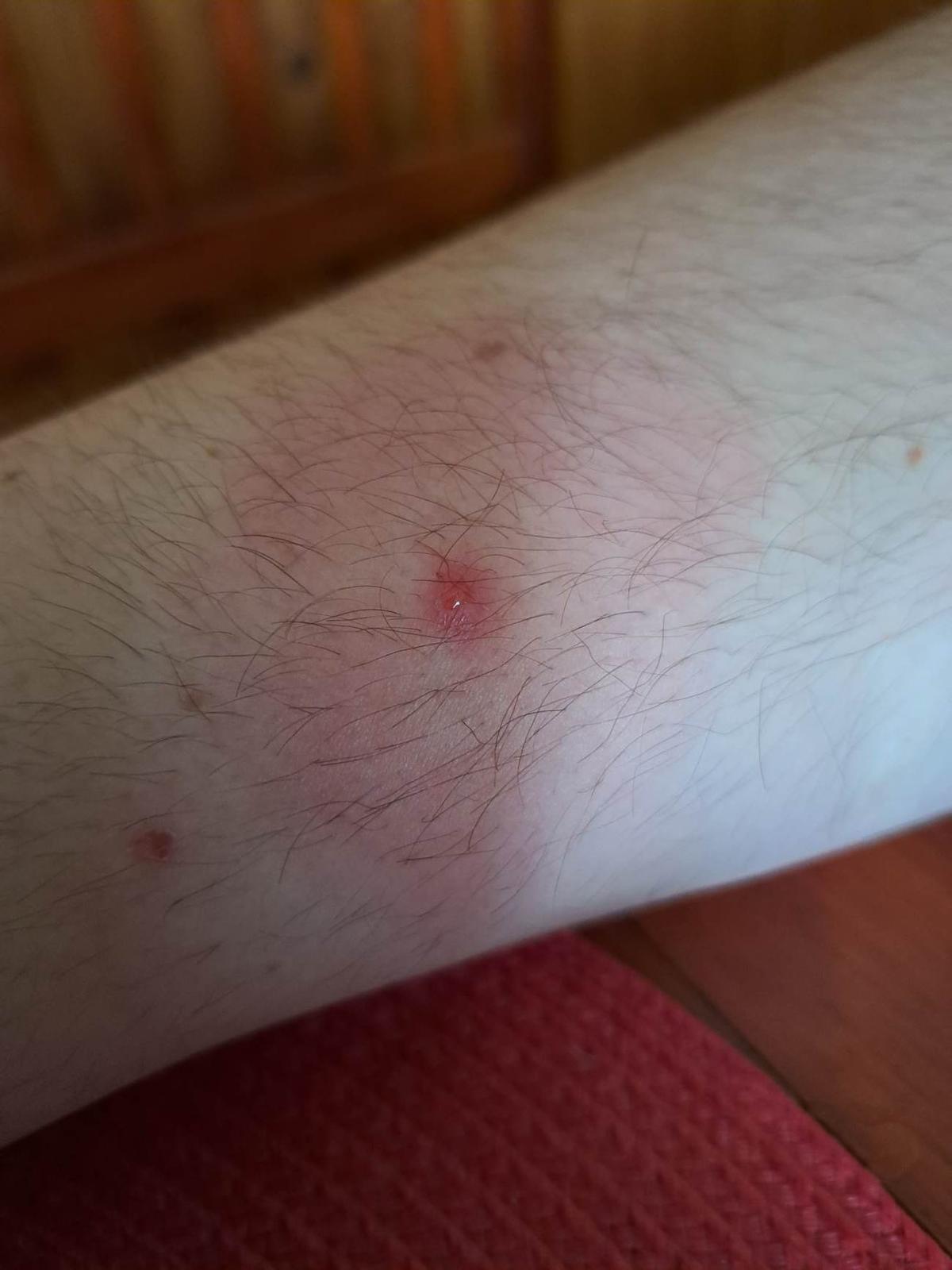 Kožný problém na synovej ruke - Modrý koník