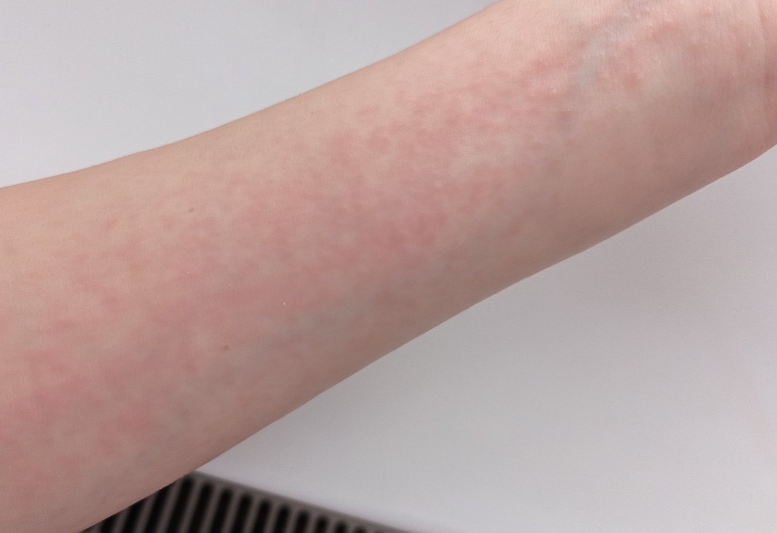 [Zodpovedané] Aké vyrážky mám na rukách? - Modrý koník