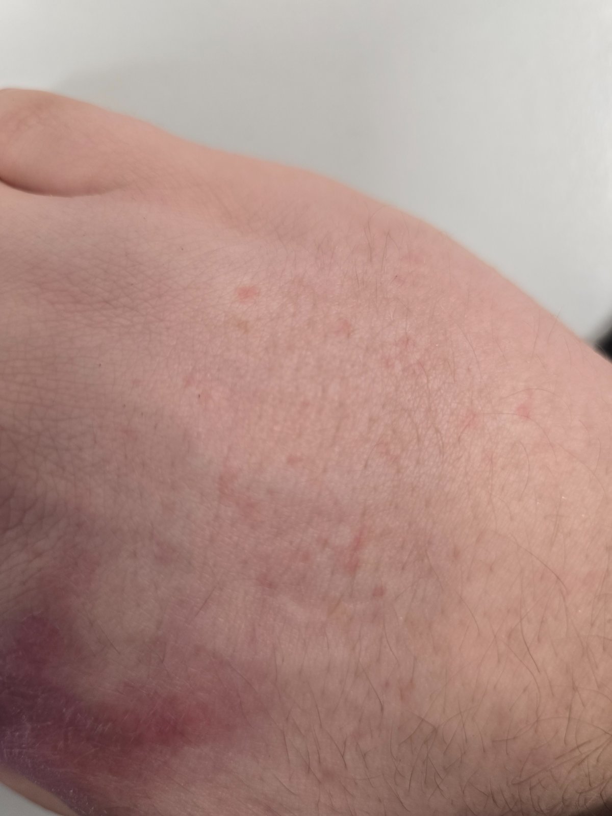 Vyrážky na rukách a tvári - Modrý koník