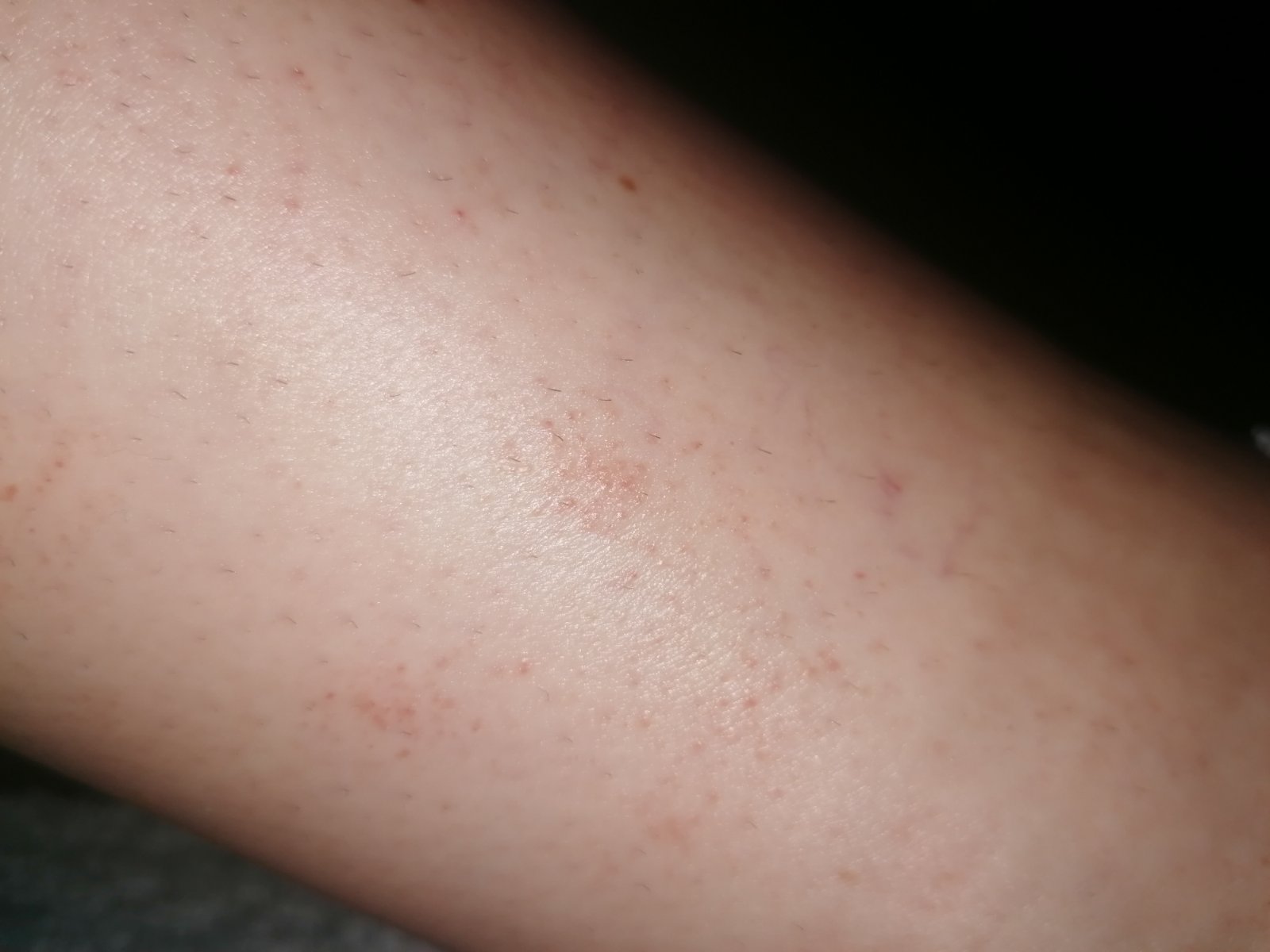 Petéchie - Modrý koník