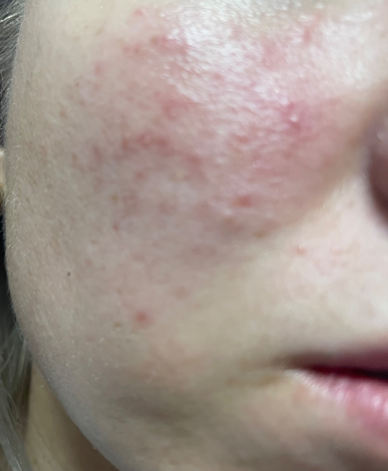 Začervenané líca - drobné krupicové pupáčiky - Modrý koník