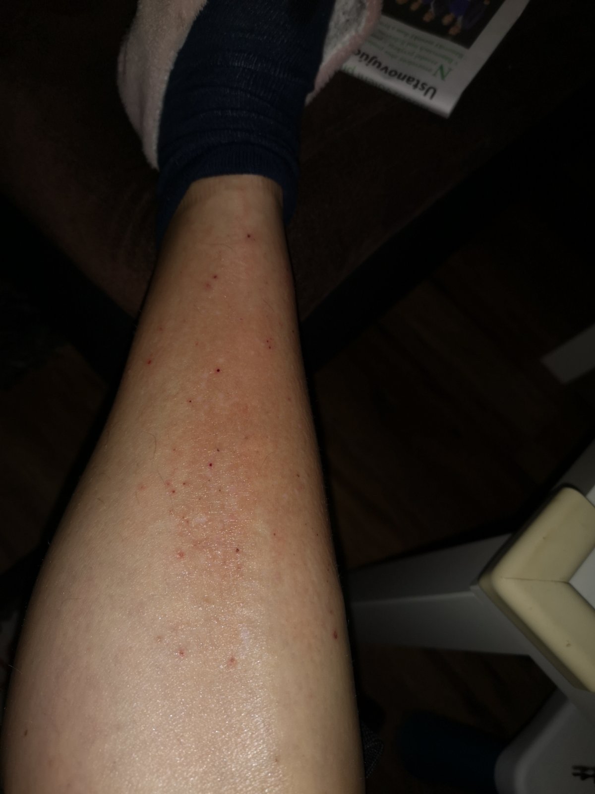 Ekzém na nohe - Modrý koník