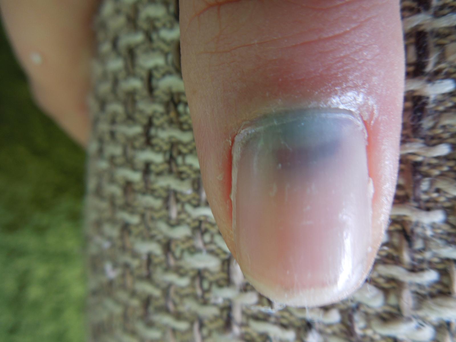 Privretý prst - Modrý koník