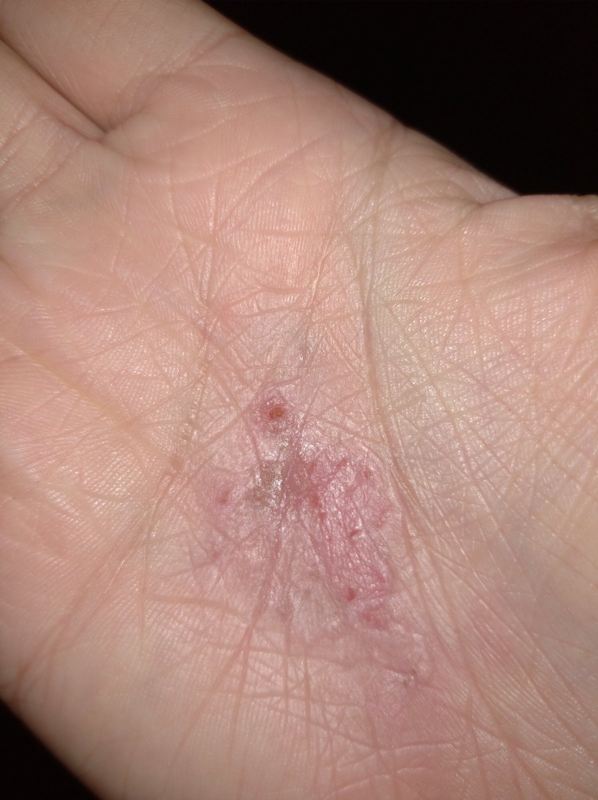 Kožný problém na rukách - Modrý koník