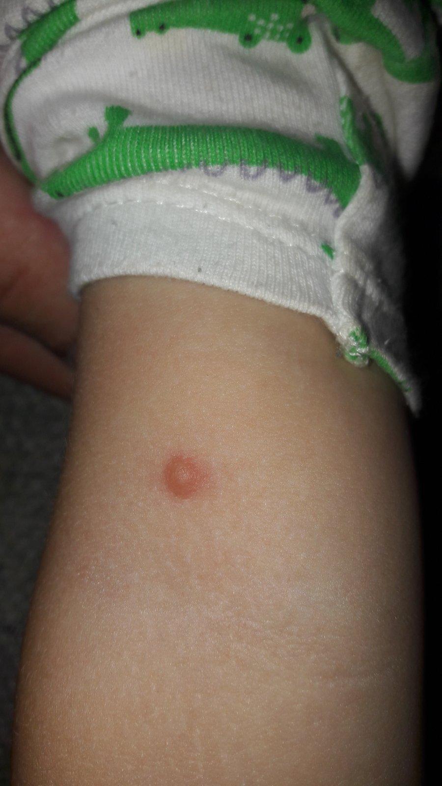 Vyrážke na ruke a nohe 13 mesačného chlapca - Modrý koník