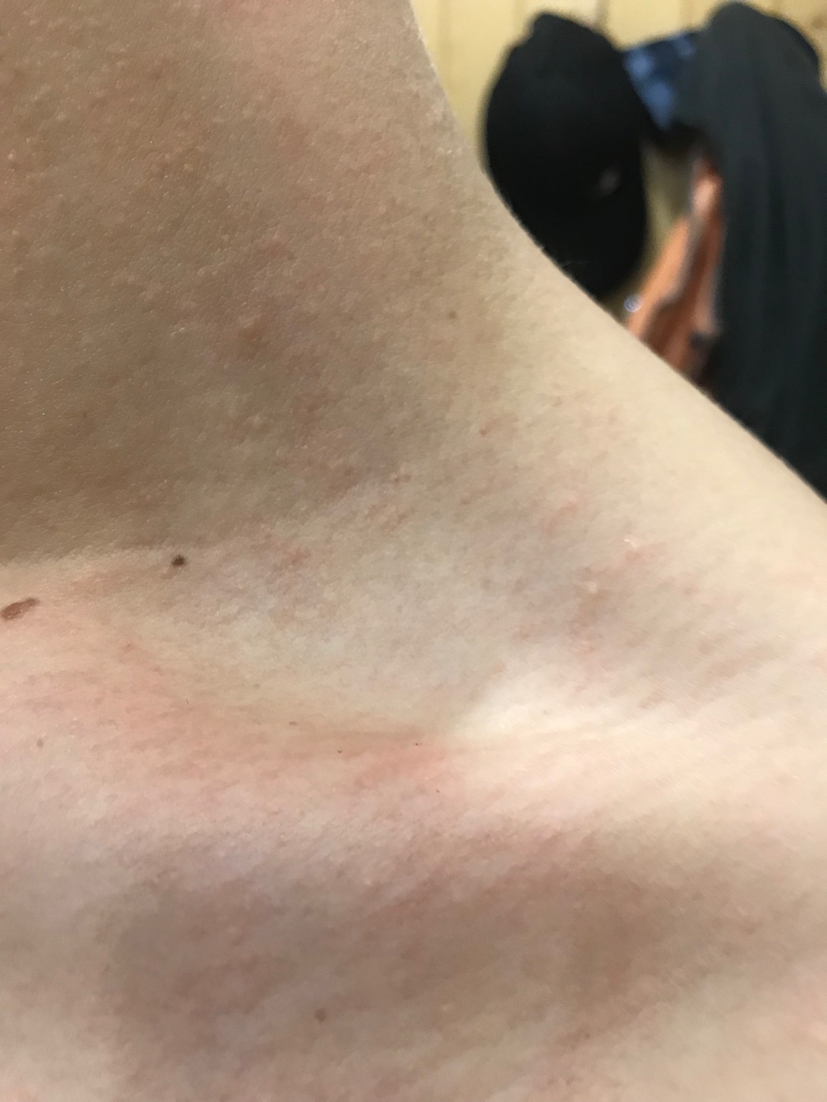 Svrbivé vyrážky u syna - Modrý koník