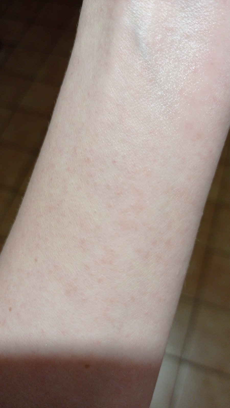 [Zodpovedané] Aké vyrážky mám na rukách? - Modrý koník