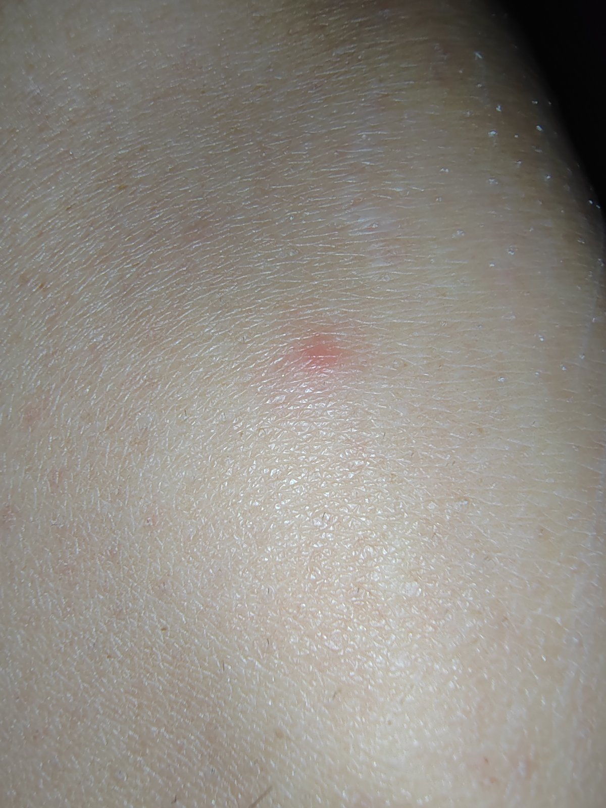 Sú to štípance od ploštice? - Modrý koník