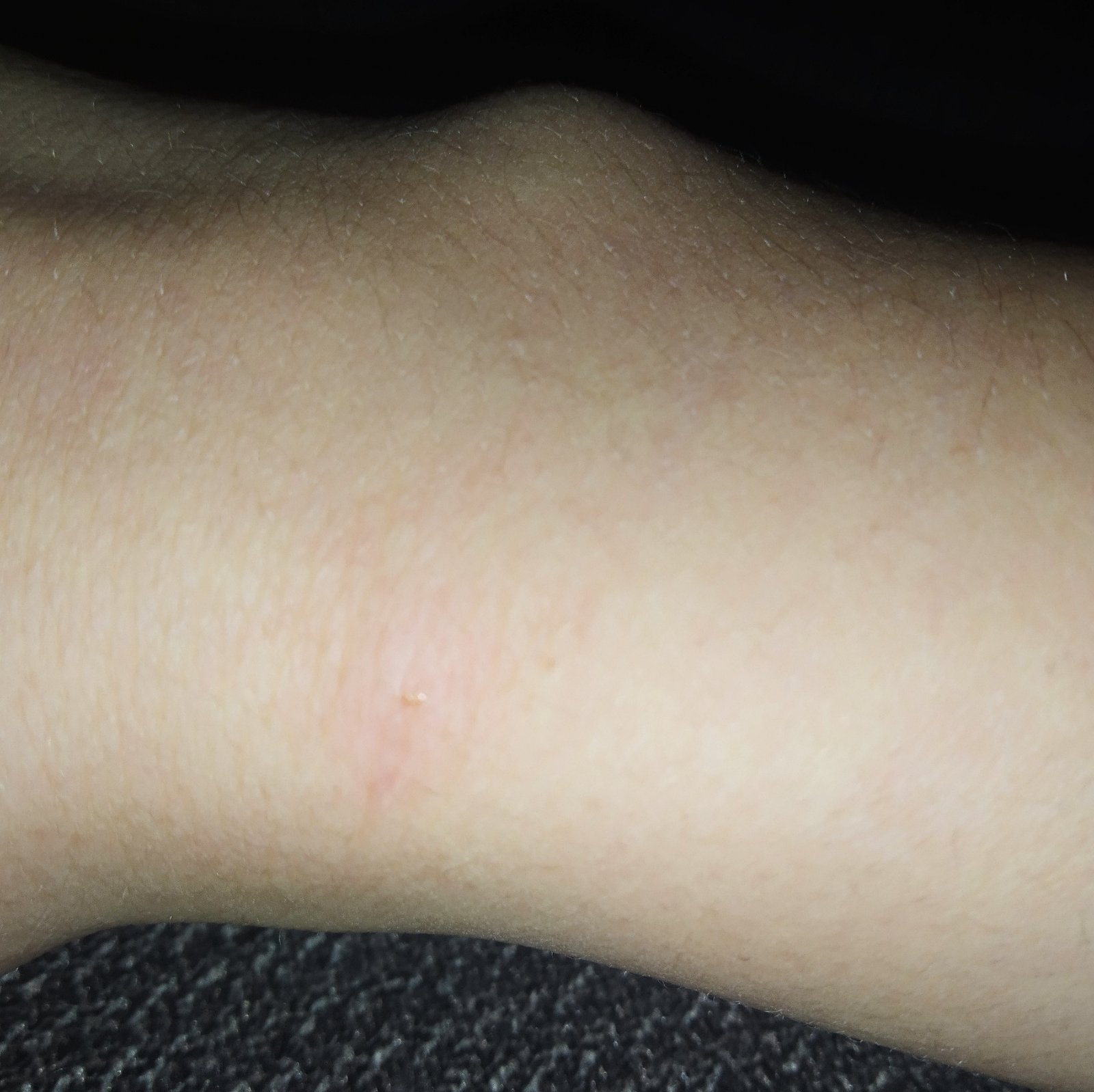 Mokrá vyrážka na ruke - Modrý koník