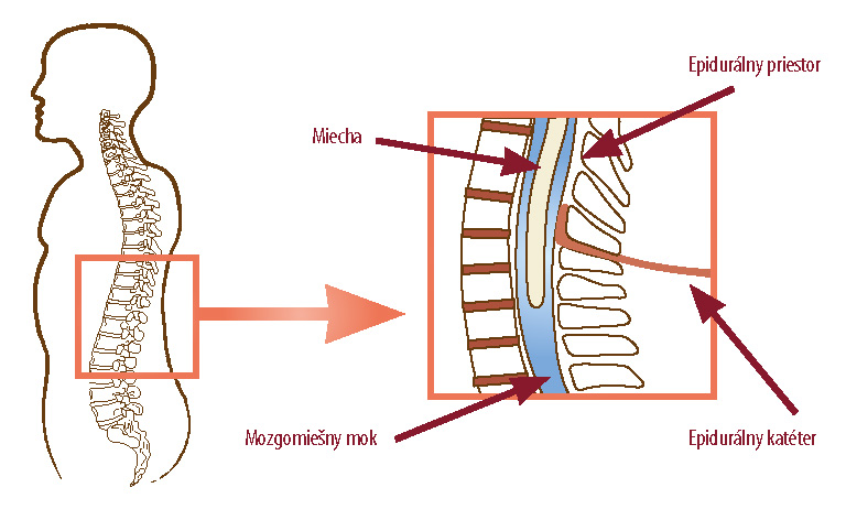 Epidurálna analgézia - Modrý koník