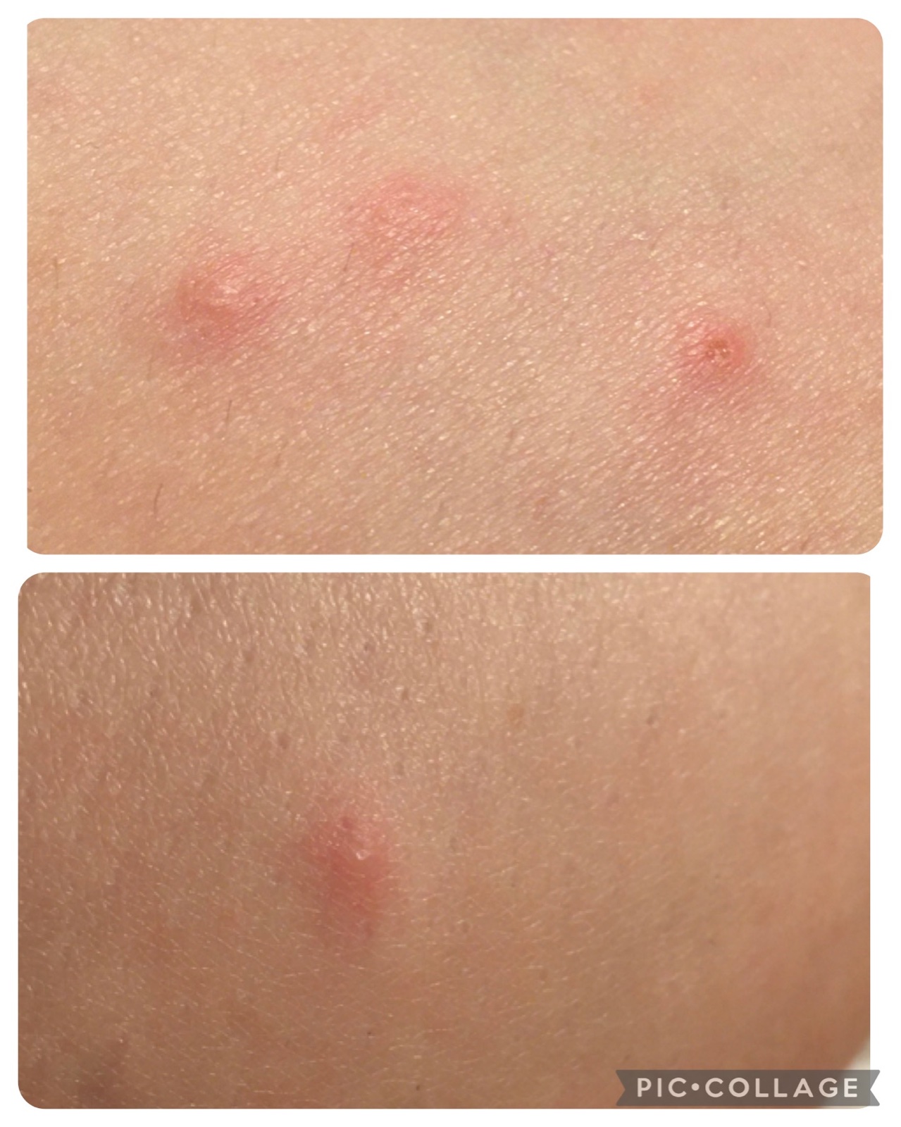 Spoznávate takéto štípance od hmyzu? - Modrý koník