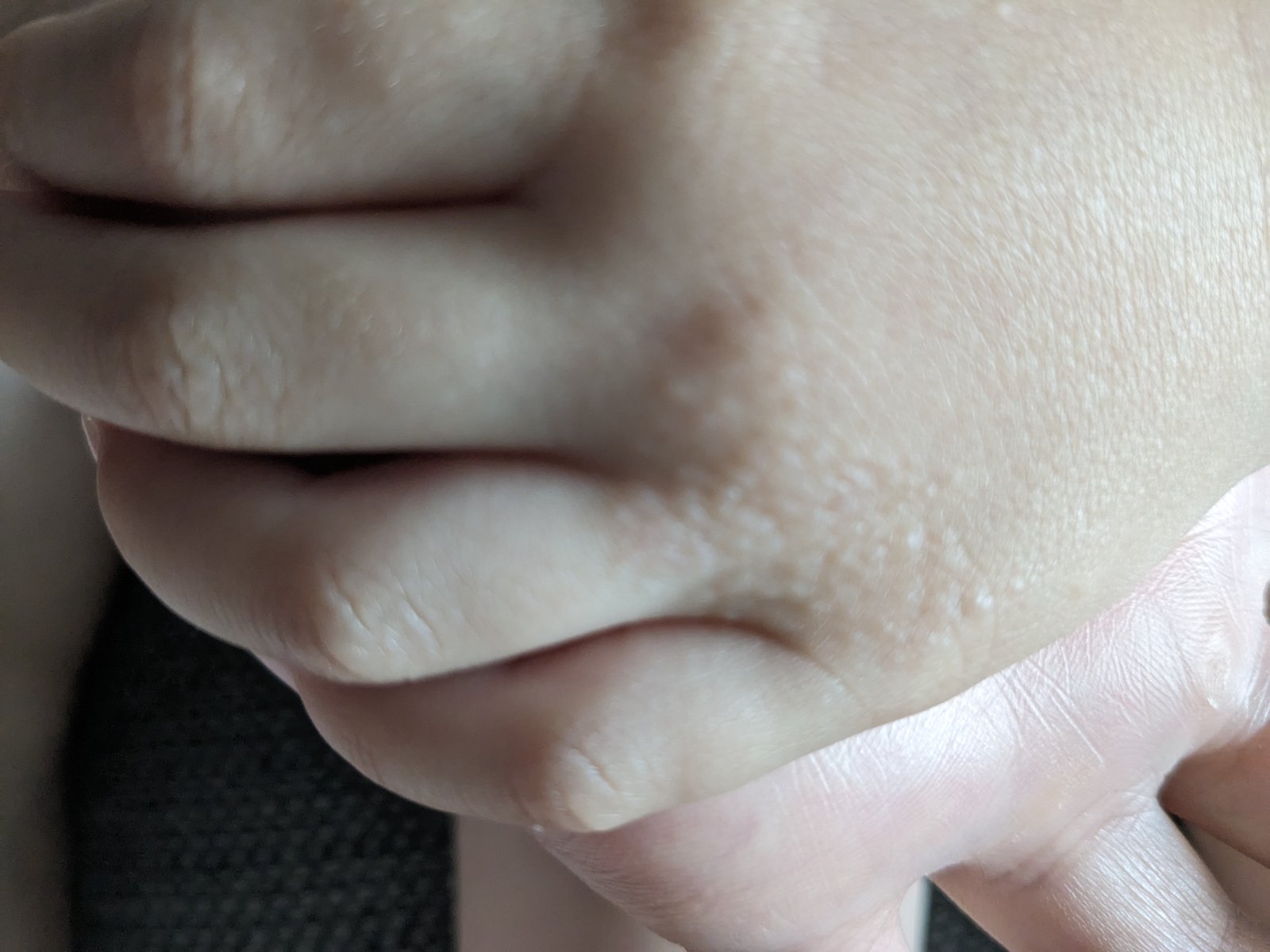 Vyrážky na rukách 3-ročného dieťaťa - Modrý koník