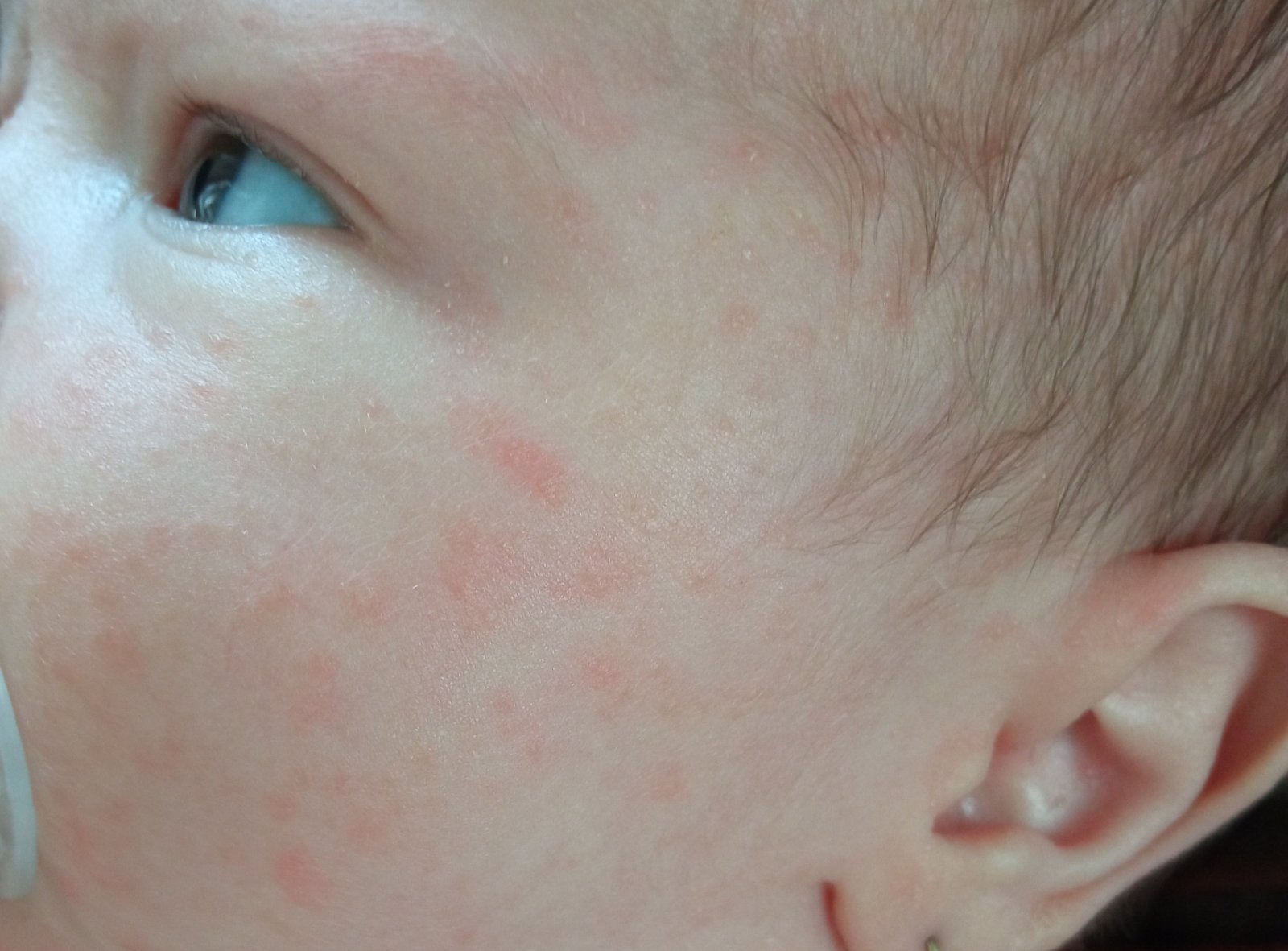 Vyrážky, ktoré sa opätovne vracajú - Modrý koník