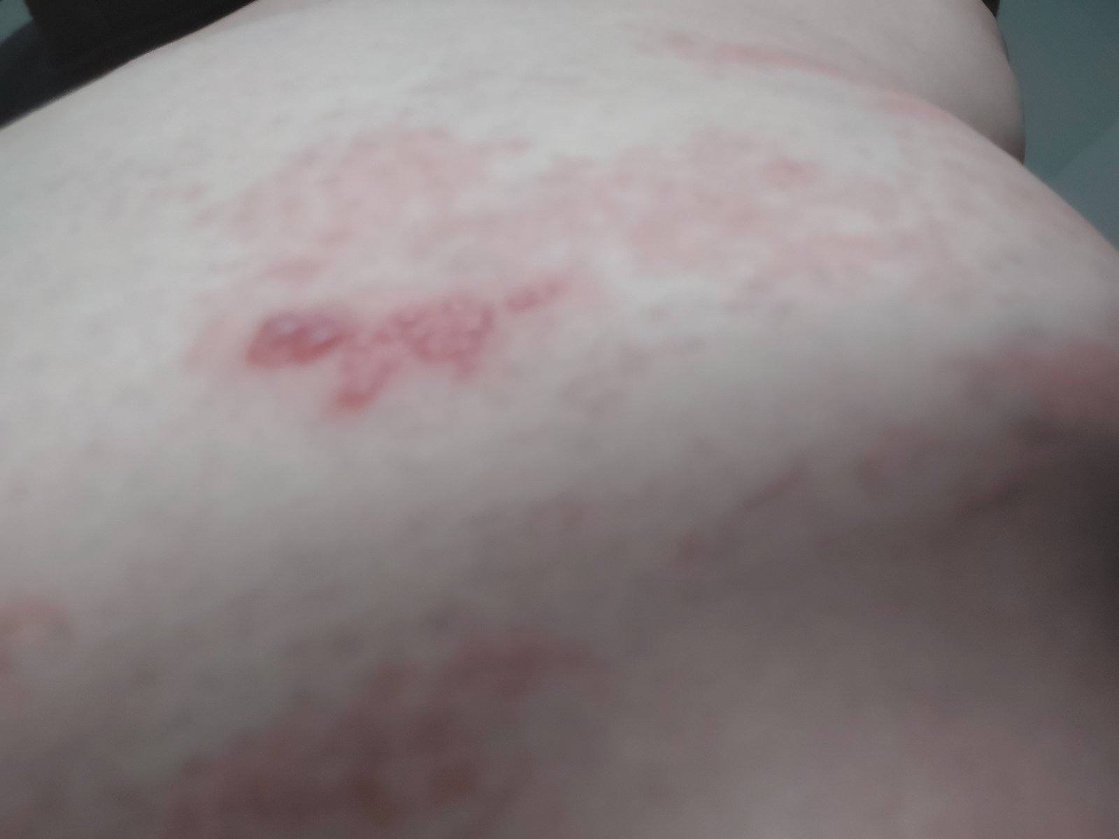 Ako riešiť vyrážky a pľuzgiere na tele? - Modrý koník