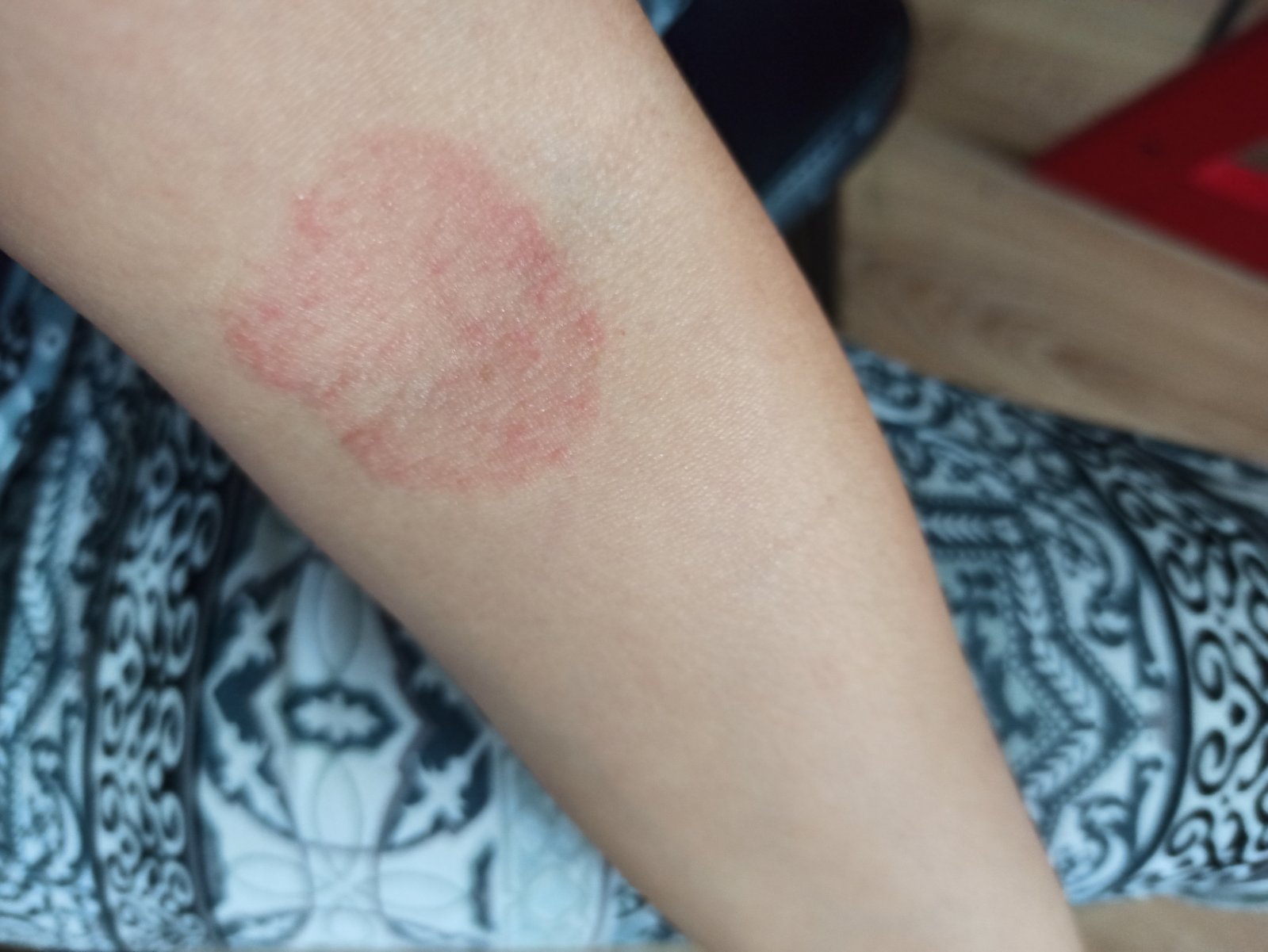 Fľaky na predlaktí - čo to môže byť? - Modrý koník