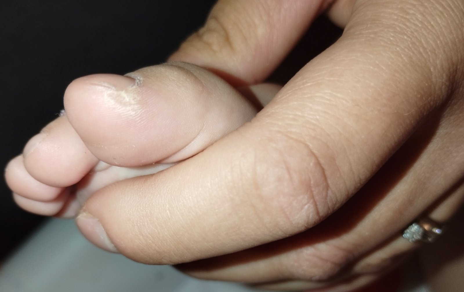 [Zodpovedané] Má moja ročná dcérka zhrubnutú kožu na palci z topánok ...