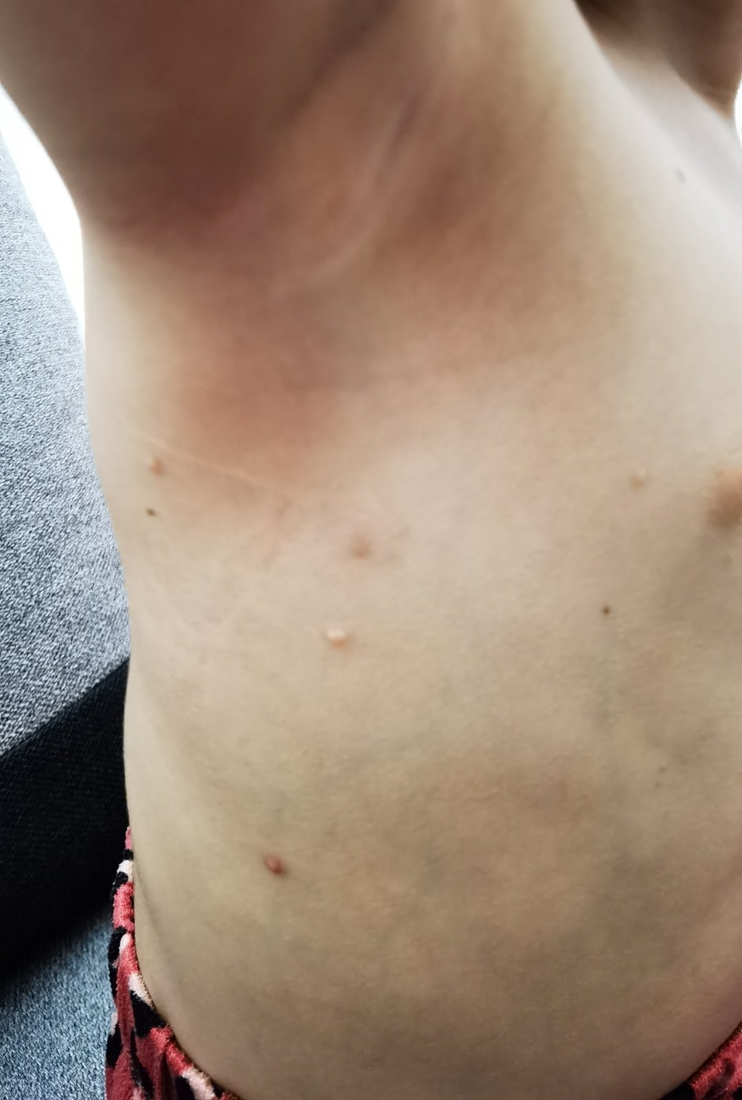 Molusky a ich odstránenie dusíkom - Modrý koník