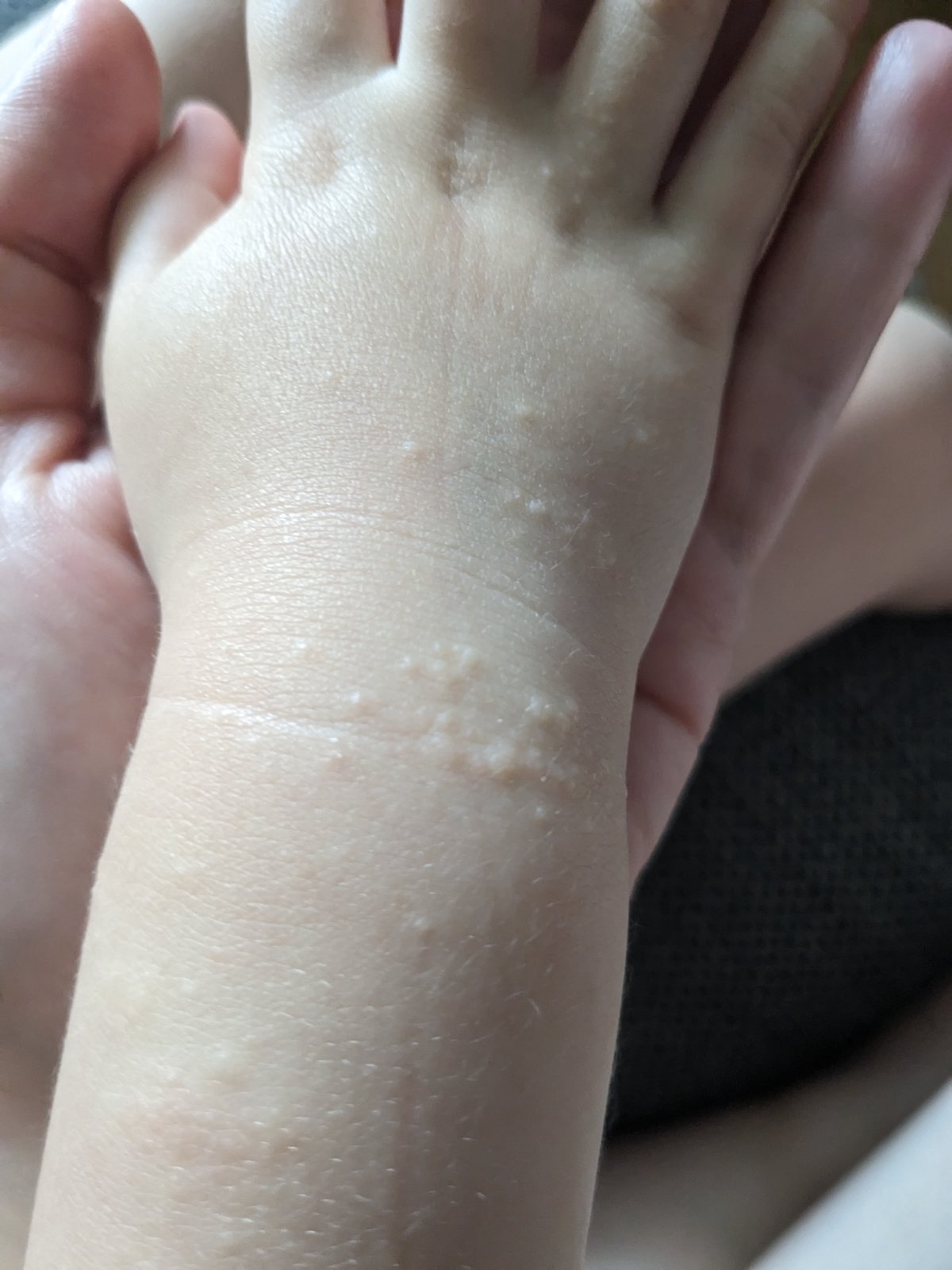 Vyrážky na rukách 3-ročného dieťaťa - Modrý koník