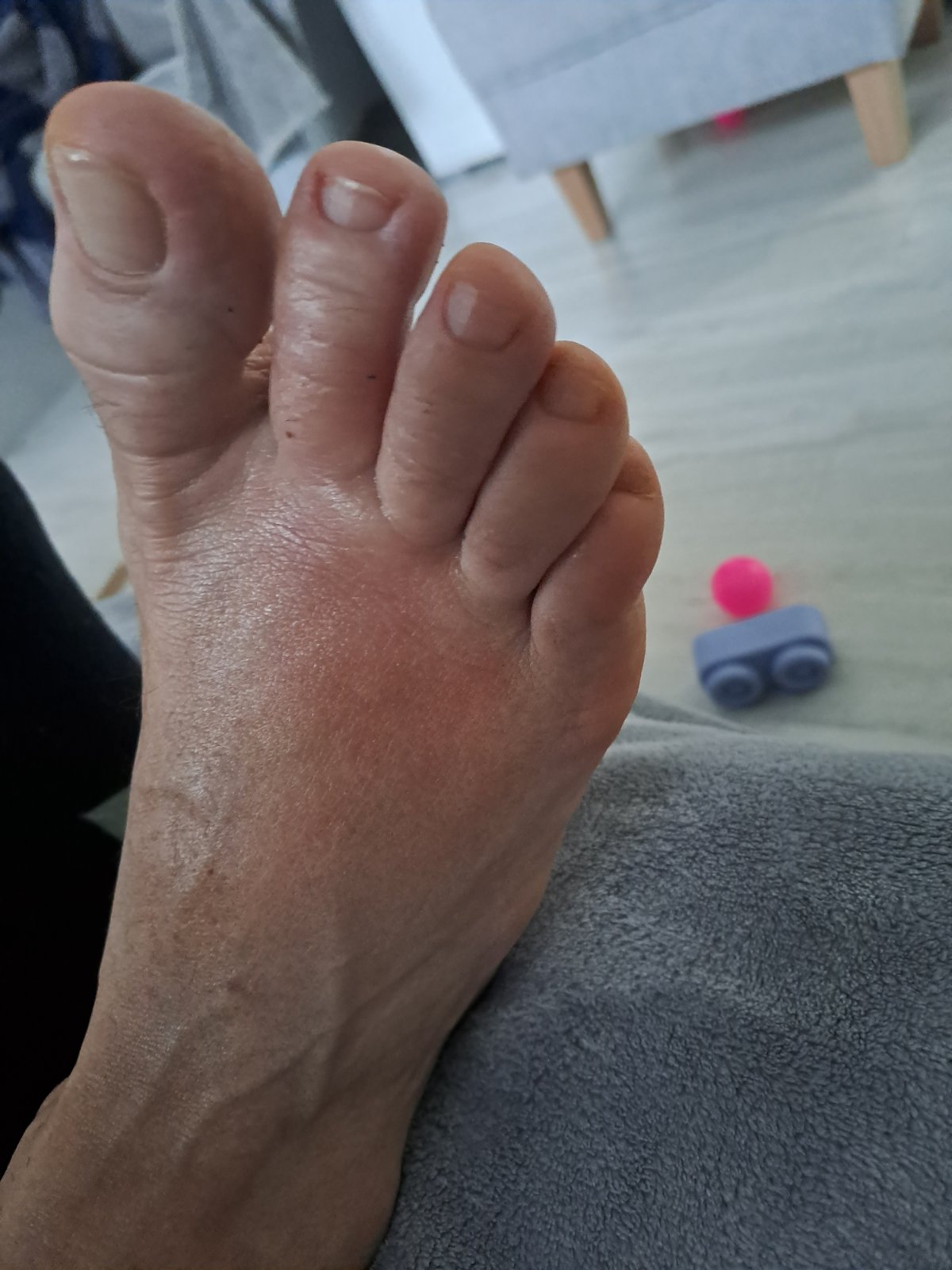 Opuch na nohe - Modrý koník