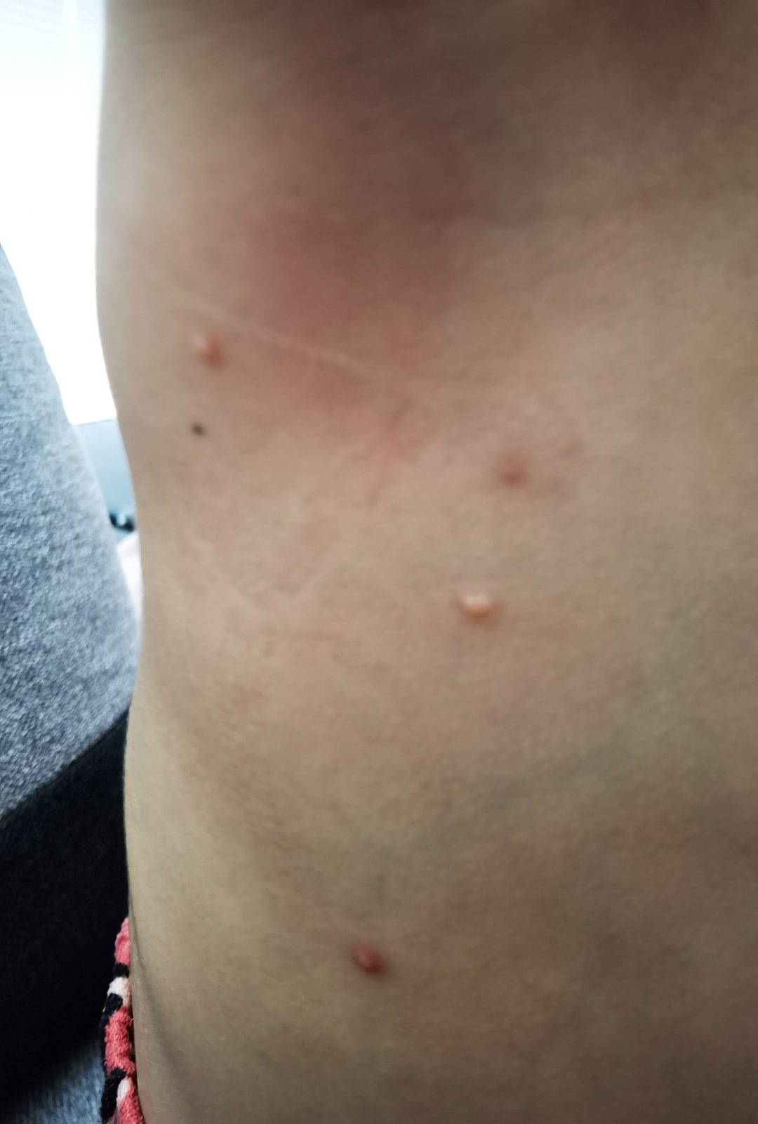 Molusky a ich odstránenie dusíkom - Modrý koník