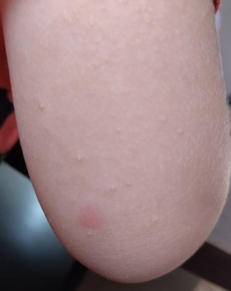 Od čoho má syn takéto štípance? - Modrý koník