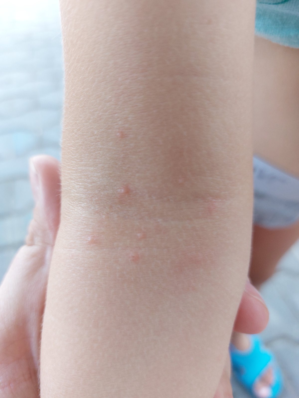 [Zodpovedané] Začínajú skoro štvorročnému synovi ovčie kiahne? - Modrý ...